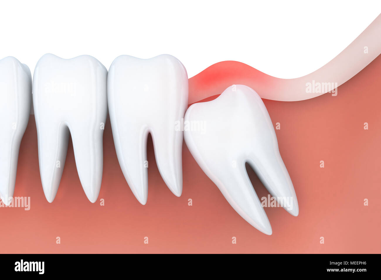 Human wisdom teeth illustration hi-res stock photography and images - Alamy