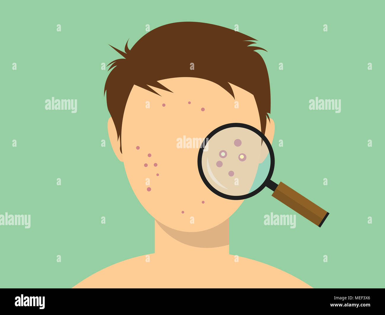 human male acne face with magnifying glass vector Stock Photo - Alamy