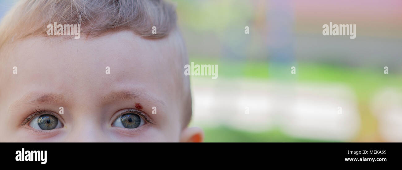 Hematoma on the eye. Bruise on the eye. Bruise of a child,. Pain ...