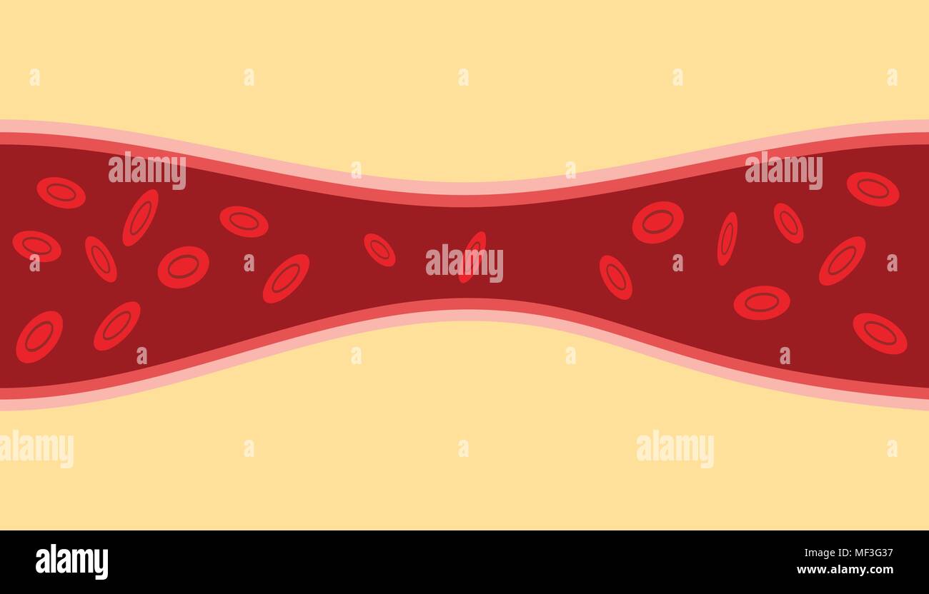 a blocked vessels with narrow stream blood cells Stock Vector Image ...