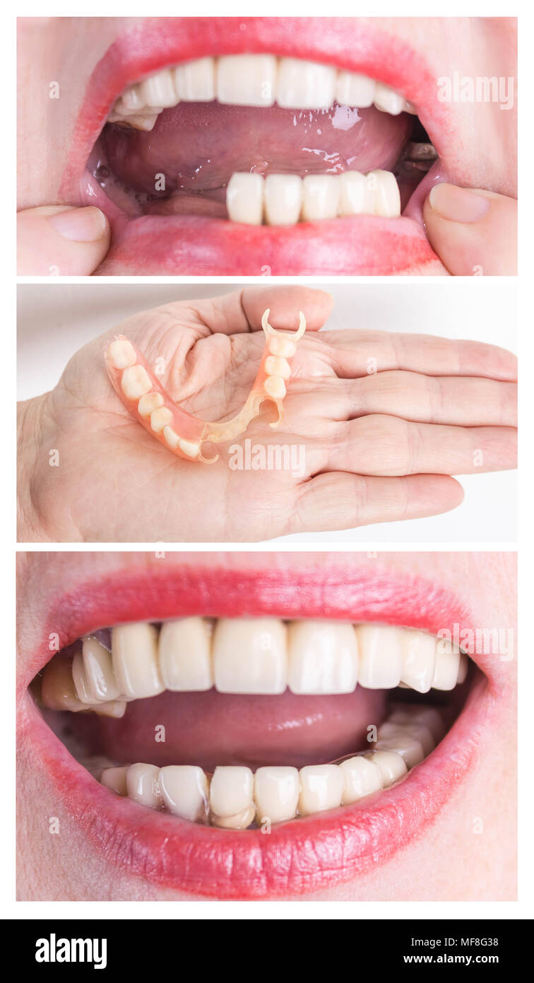 Dental rehabilitation with lower flexible nylon denture, before and ...