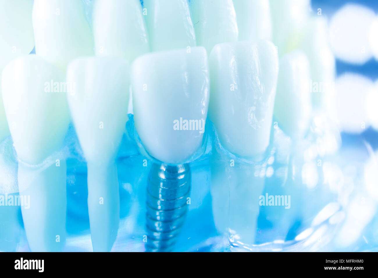 Dental titanium aesthetic orthodontic tooth implant in dentists mouth ...
