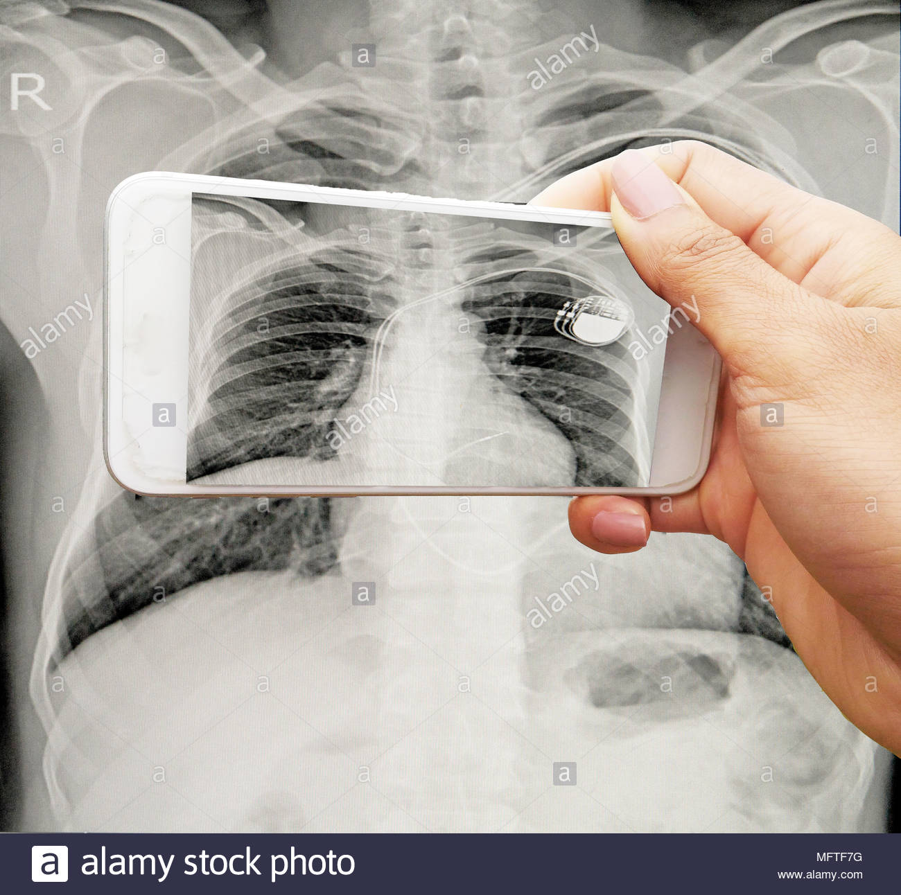 Implant Pacemaker Stock Photos & Implant Pacemaker Stock Images - Alamy