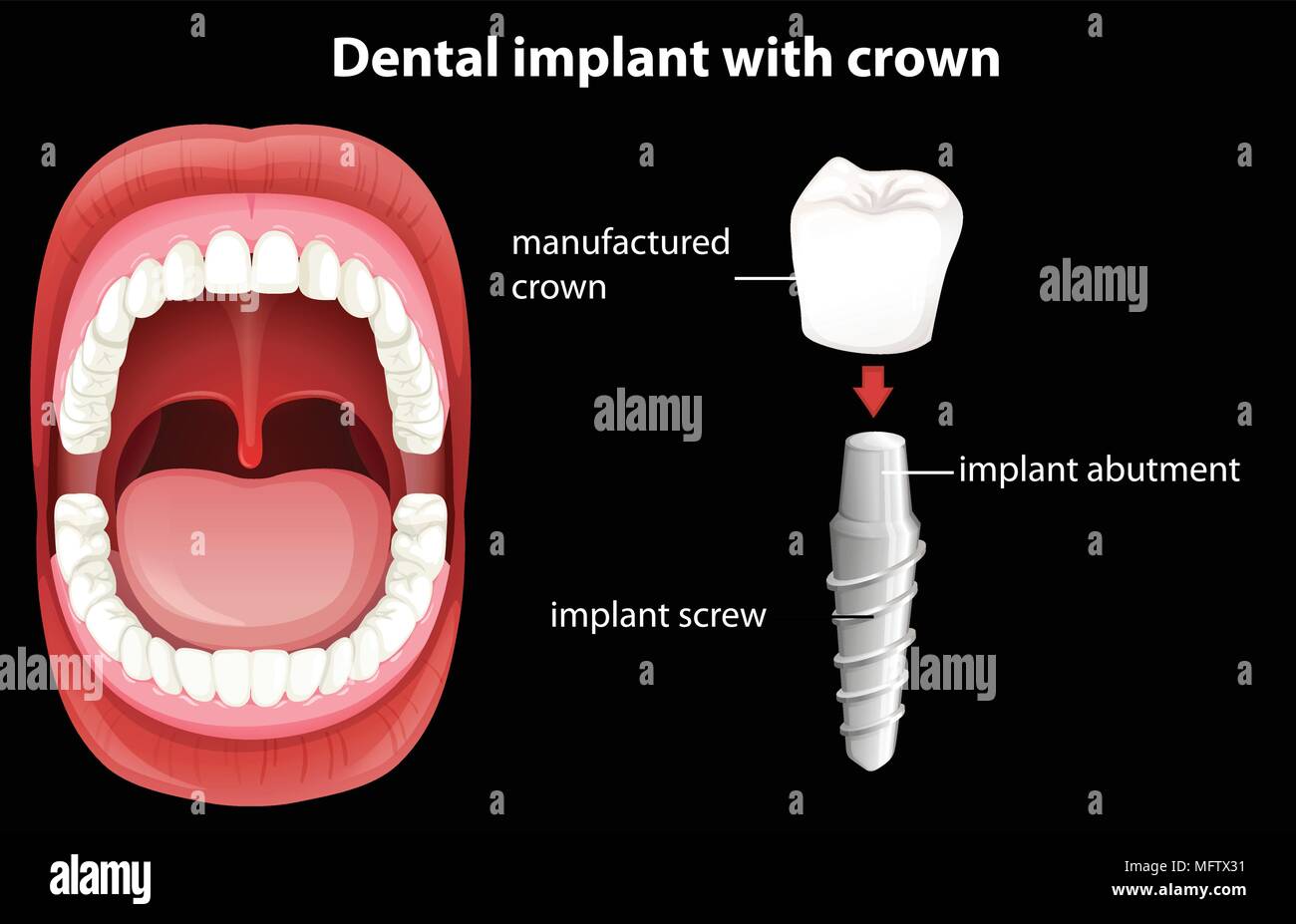 Medical Vector of Dental Implant illustration Stock Vector Image & Art ...