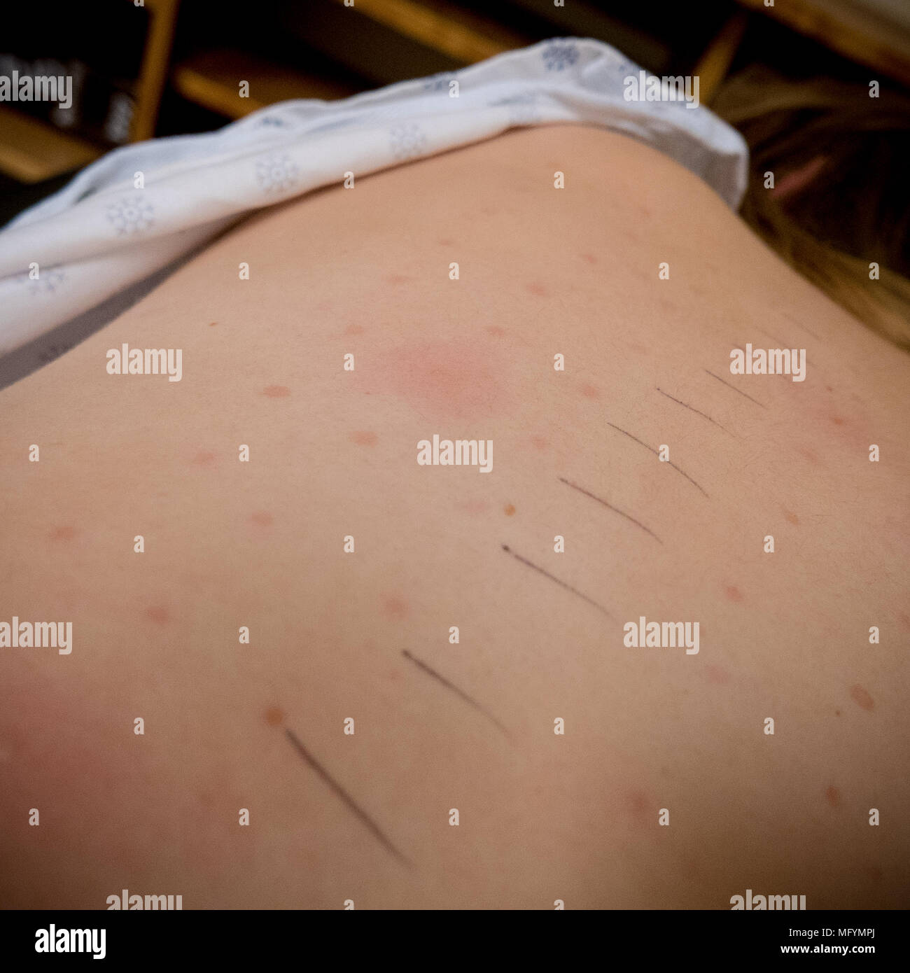 skin prick allergy test on the back of a 13 yo girl Stock Photo - Alamy