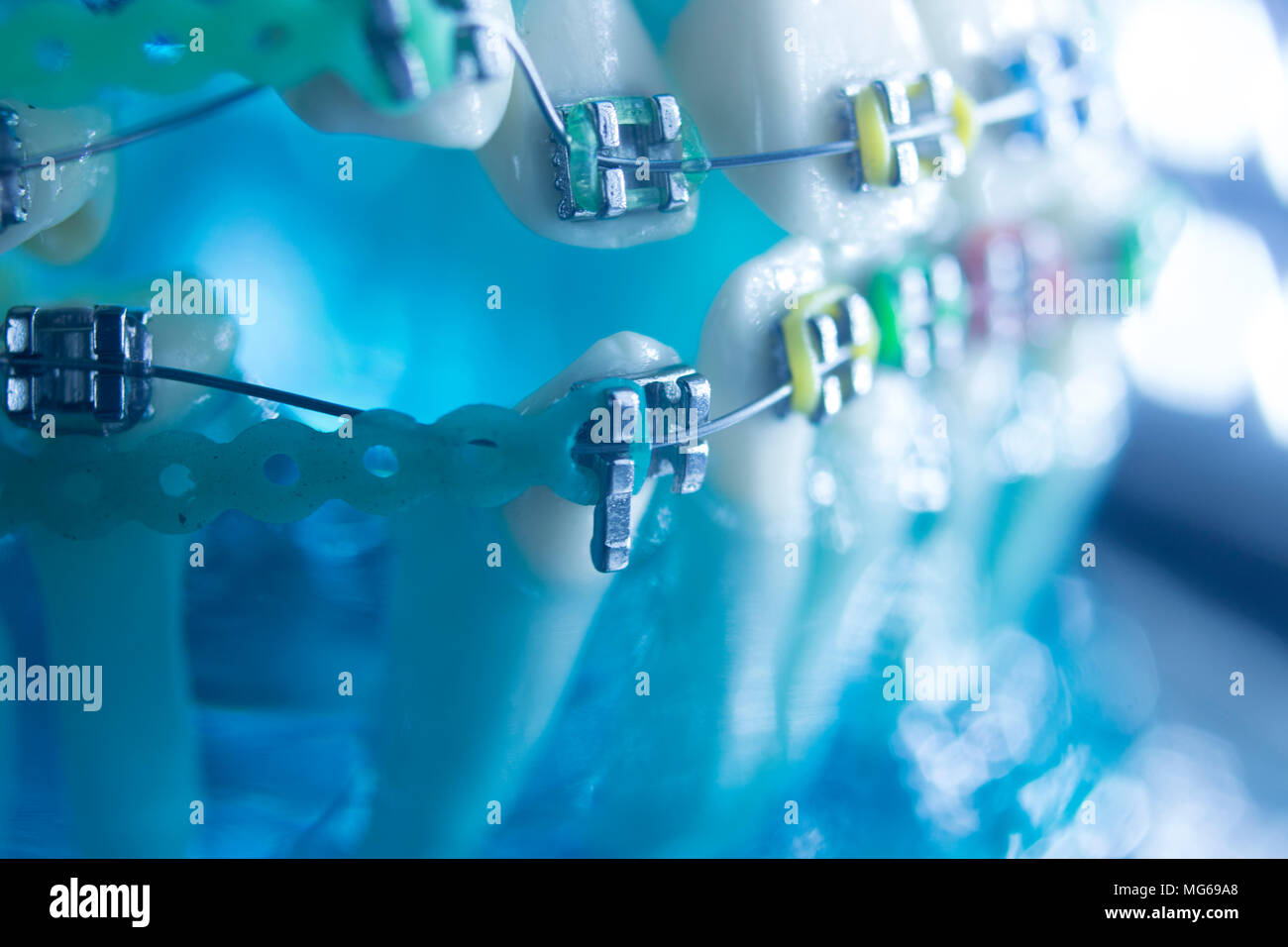 Dental teeth retainers metal aligners brackets to straighten teeth in ...