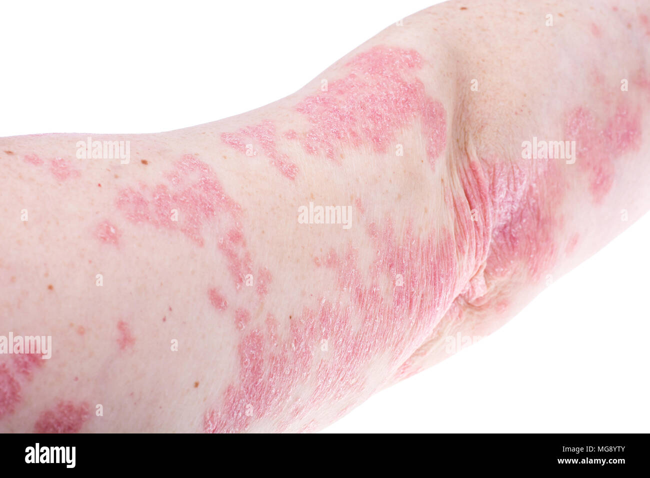Plaque Psoriasis Stock Photos & Plaque Psoriasis Stock Images - Alamy