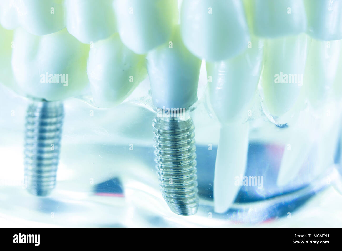 Dental titanium aesthetic orthodontic tooth implant in dentists mouth ...