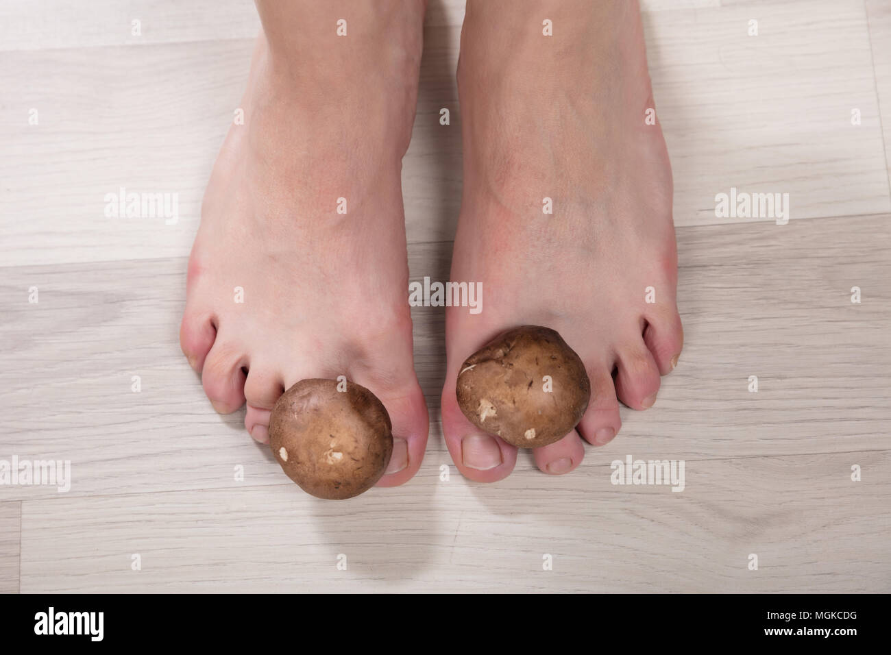 Close-up Of A Woman's Feet With Edible Mushrooms Between The Toes Stock ...