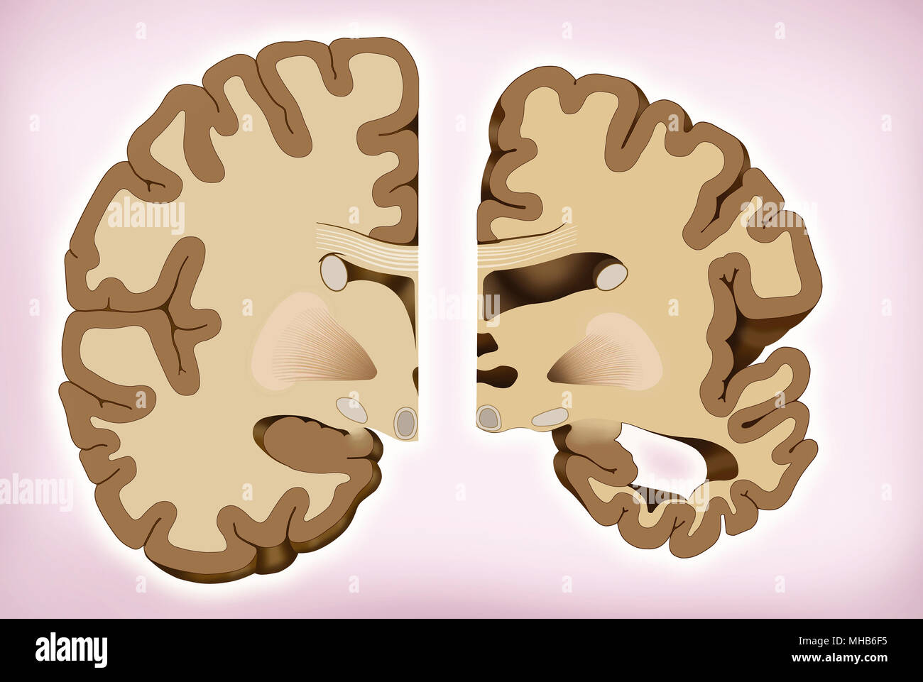 Alzheimers neurodegenerative disease dementia hi-res stock photography ...
