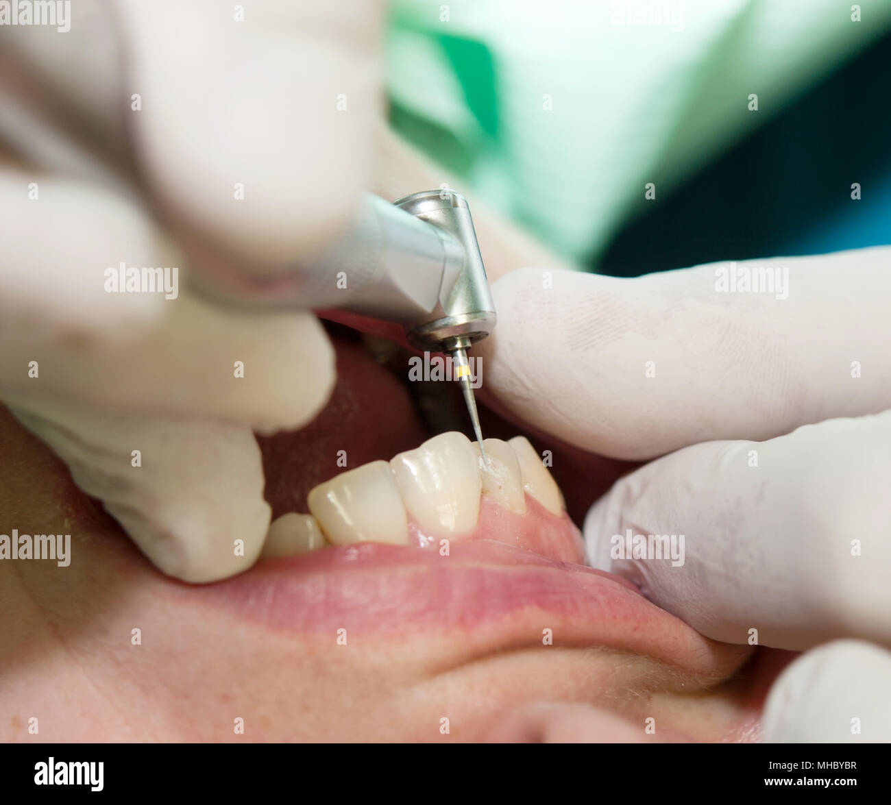 Detail of finishing dental filling on front tooth Stock Photo - Alamy