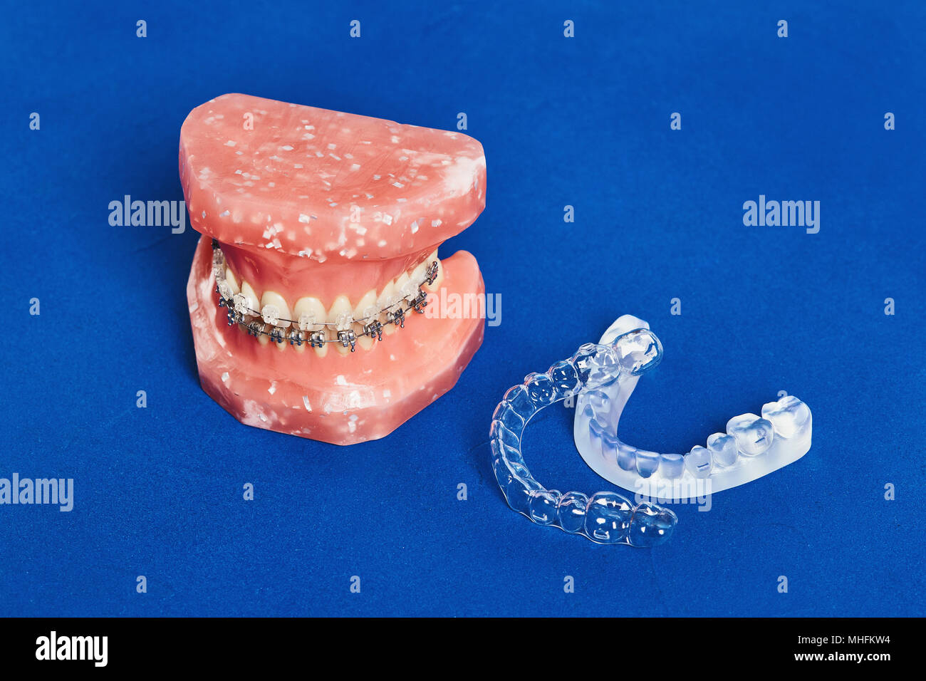 Human jaw or teeth model with metal wired dental braces, orthodontic ...