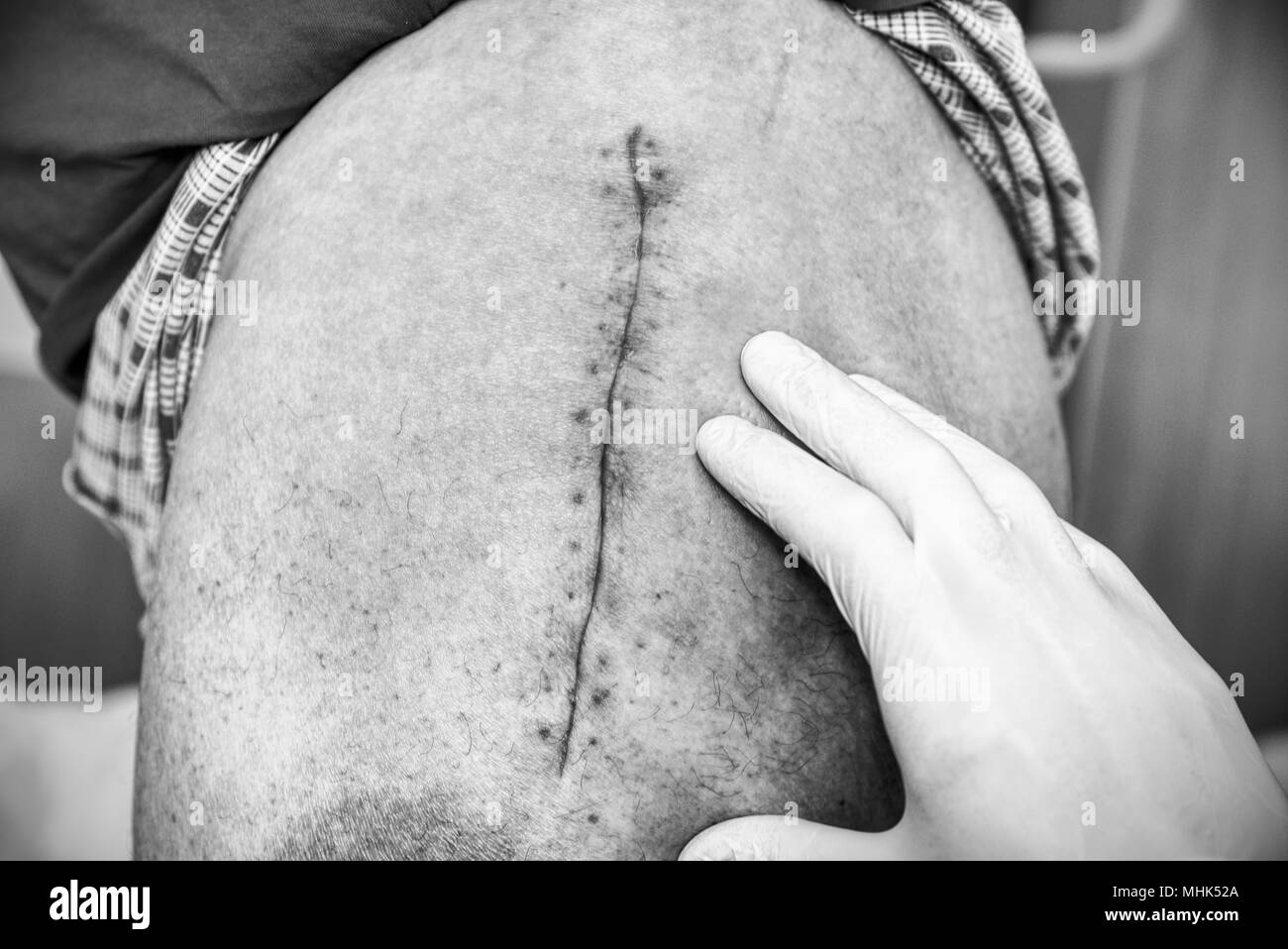 Pacemaker scar tattoo - Bronctattooaus.com