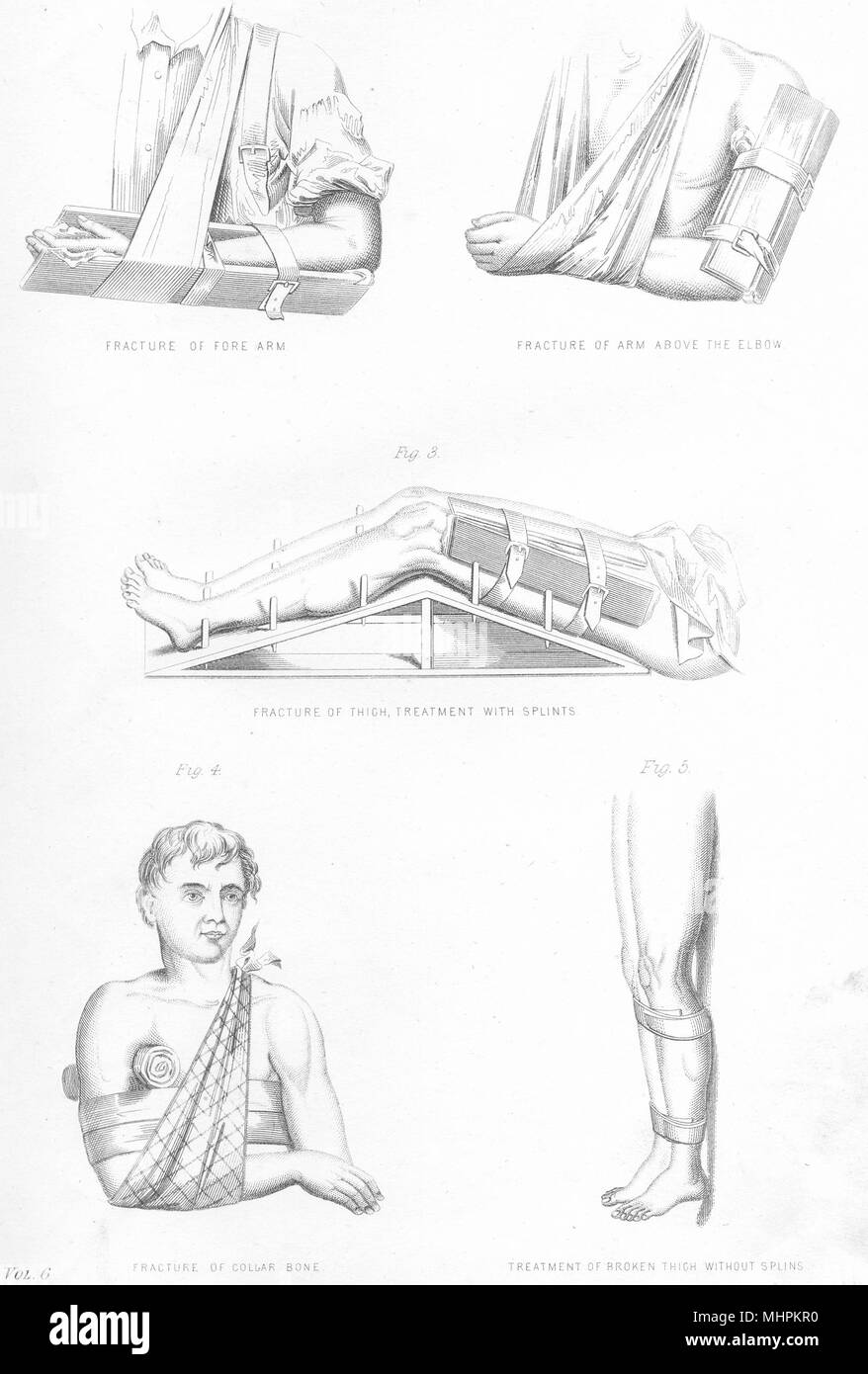 MEDICAL. Fractures; Fore Arm; above Elbow; thigh; Splints; Collar bone ...