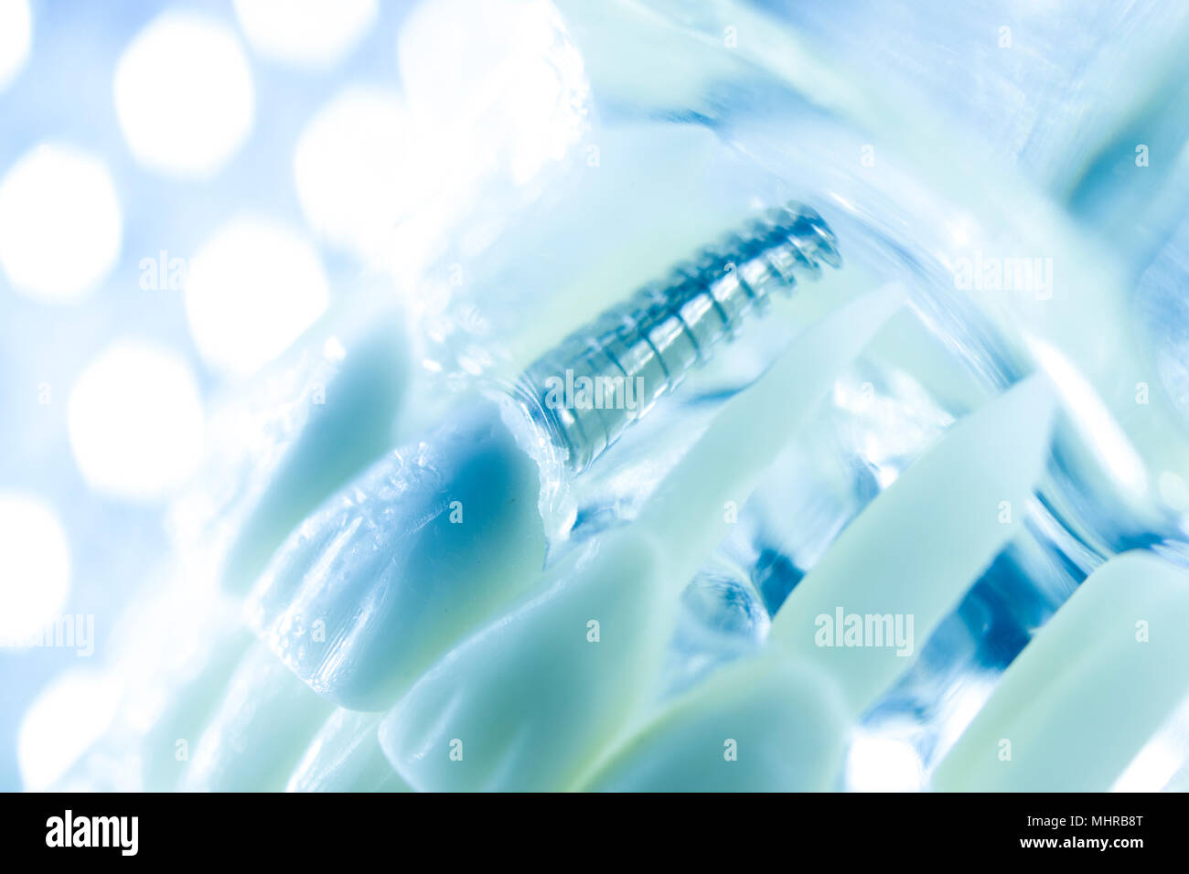 Dental titanium aesthetic orthodontic tooth implant in dentists mouth ...