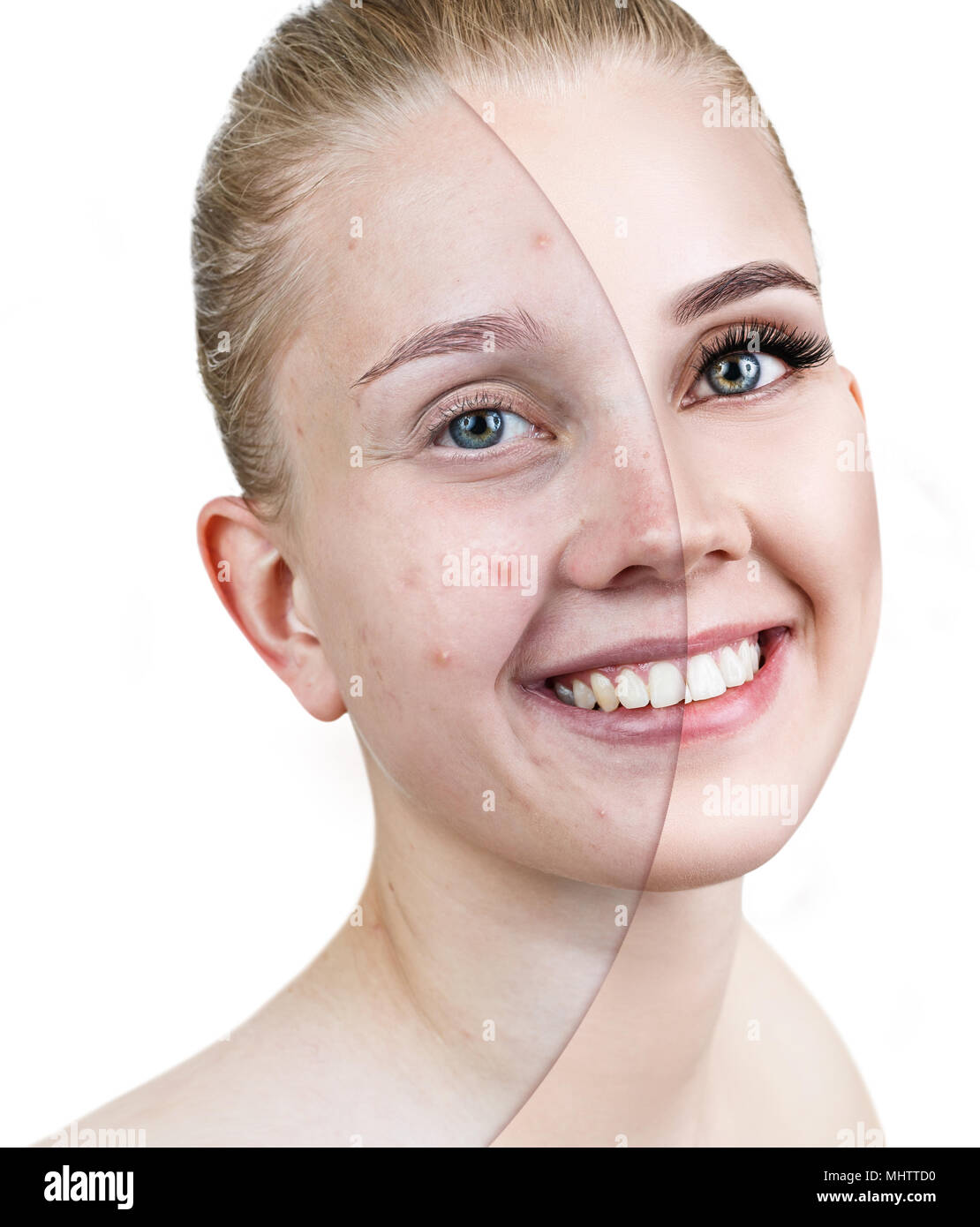 Woman with acne before and after treatment and make-up Stock Photo - Alamy