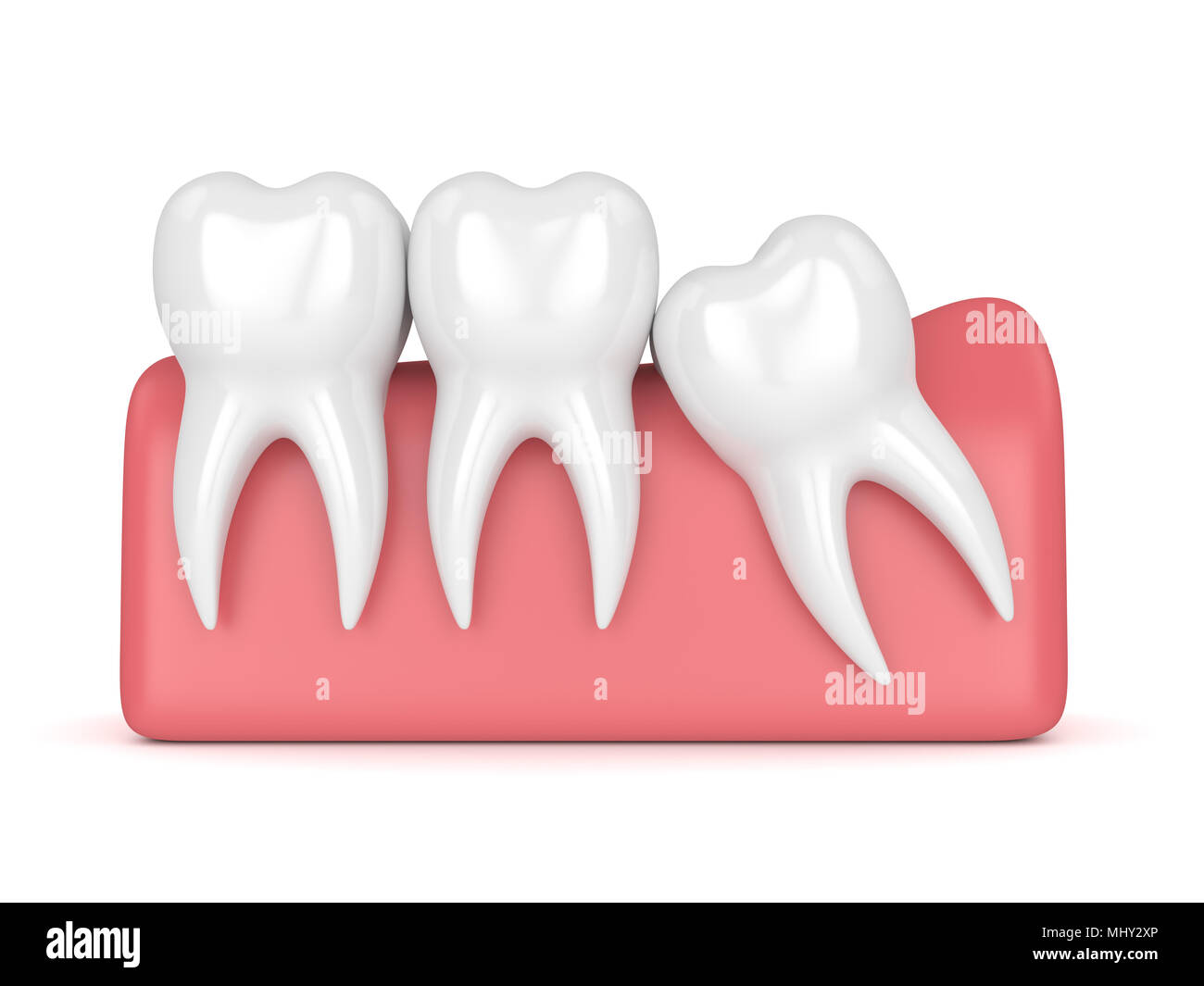3d render of teeth with wisdom mesial impaction over white background ...