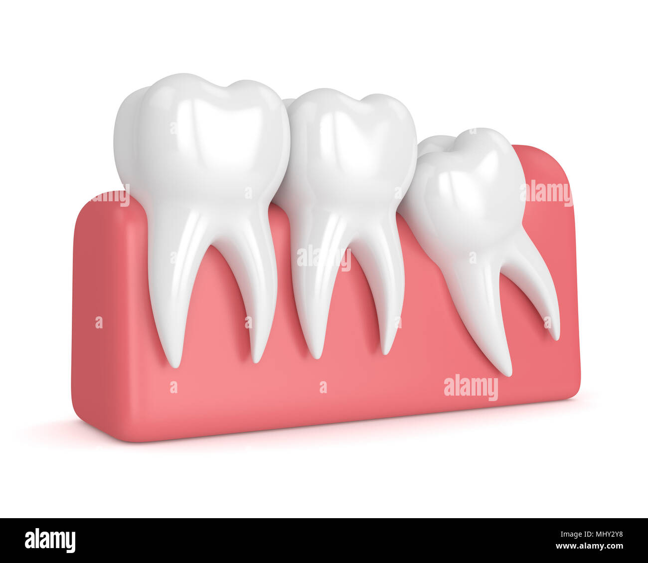 3d render of teeth with wisdom mesial impaction over white background ...