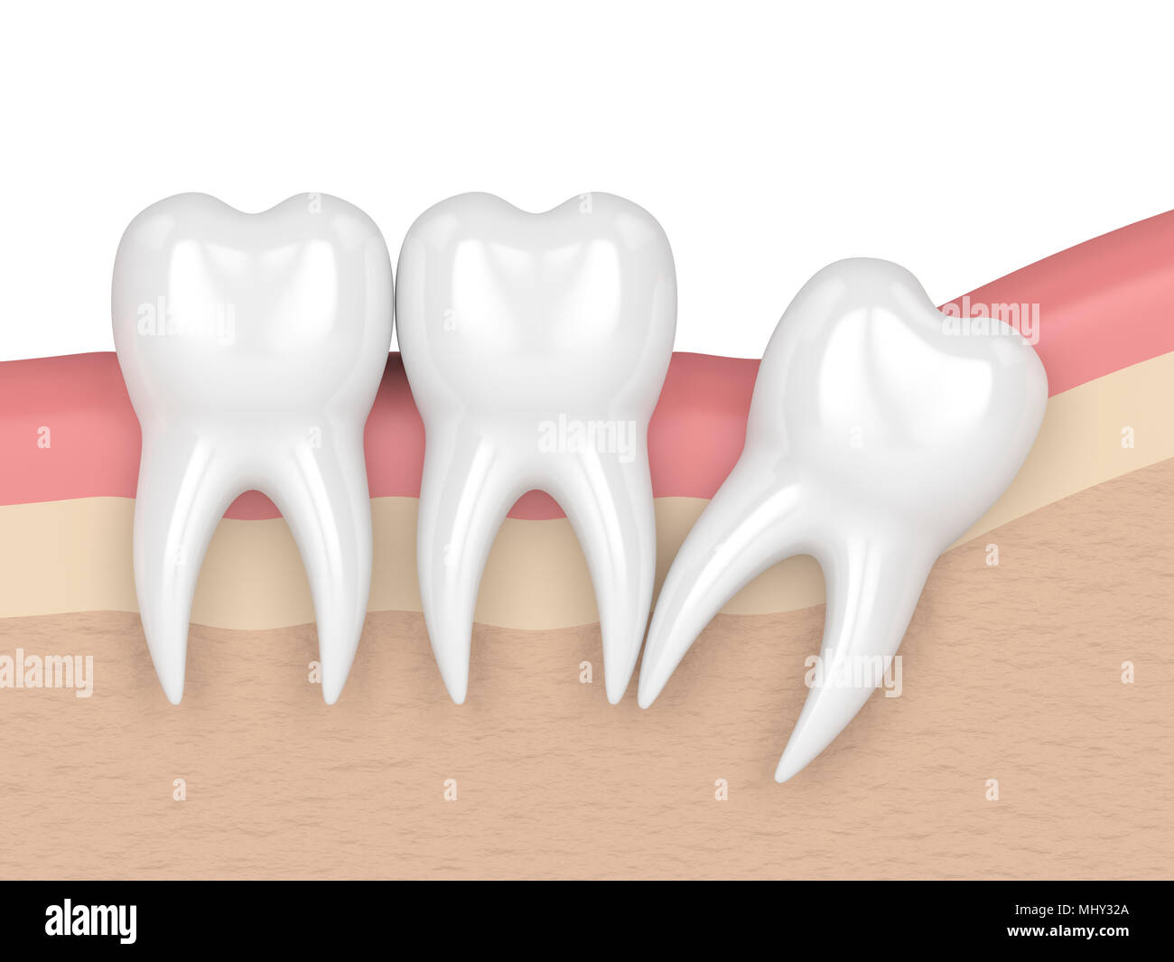 3d render of teeth with wisdom distal impaction. Concept of different ...