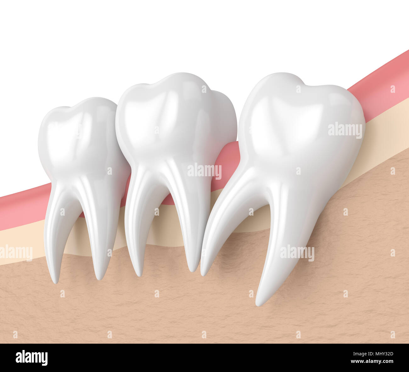 3d render of teeth with wisdom distal impaction. Concept of different ...