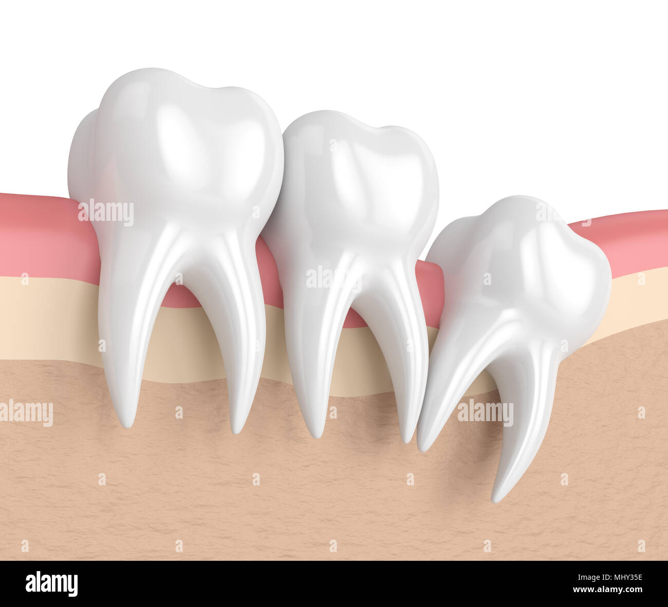 3d render of teeth with wisdom distal impaction. Concept of different ...