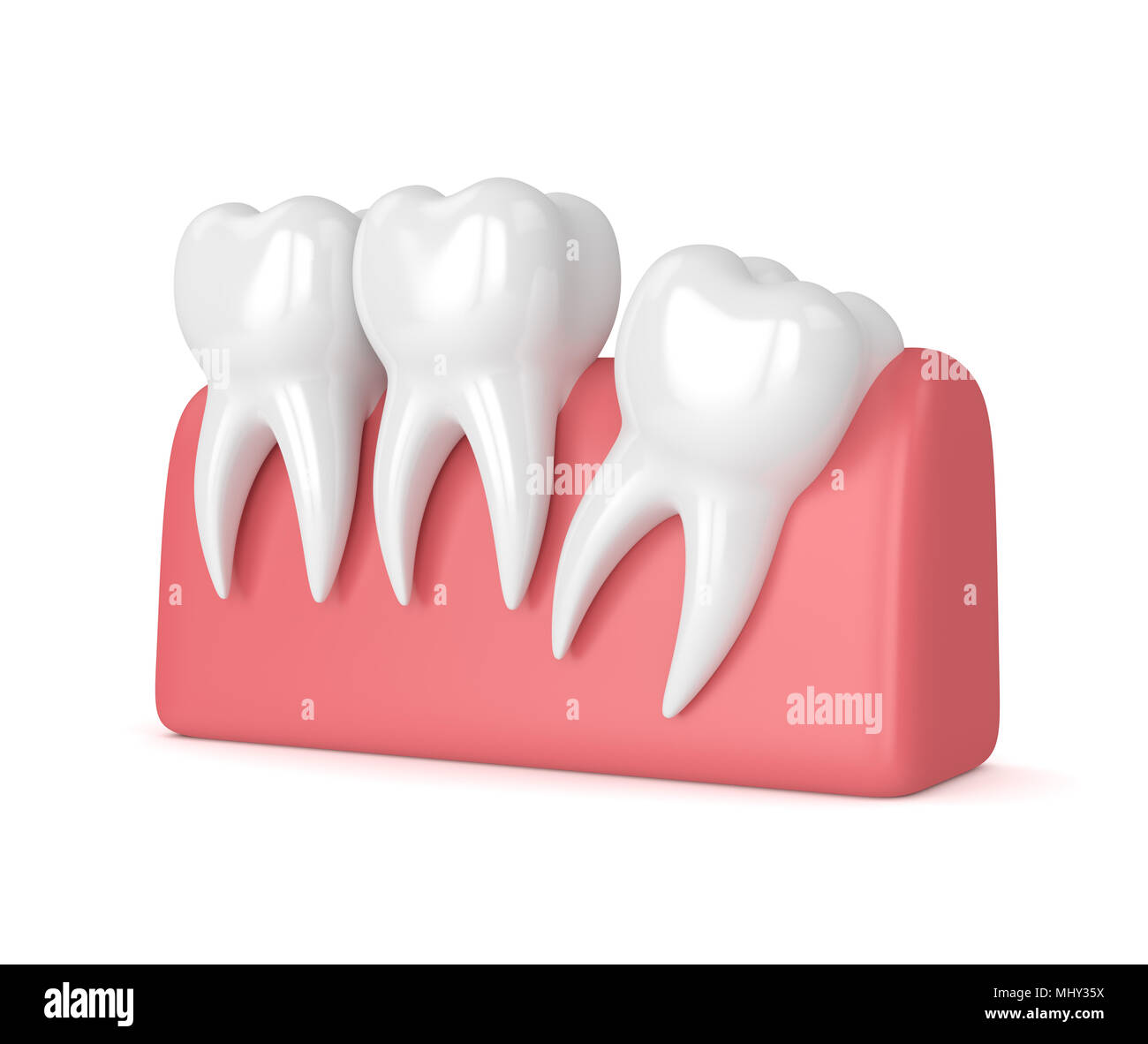 3d render of teeth with wisdom distal impaction over white background ...