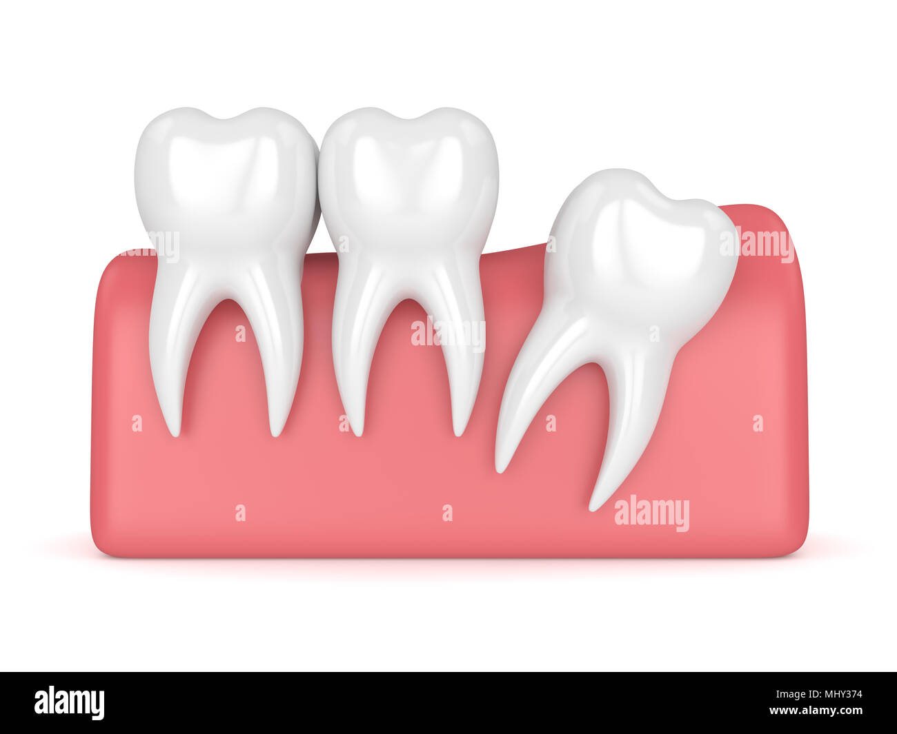 3d render of teeth with wisdom distal impaction over white background ...