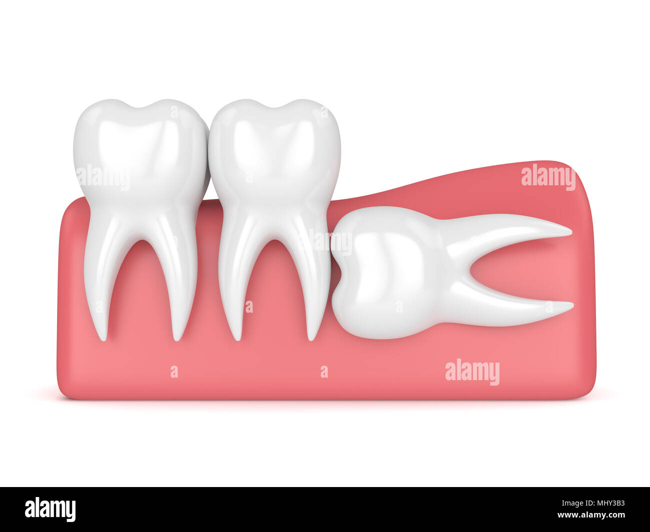 3d render of teeth with wisdom horizontal impaction over white ...