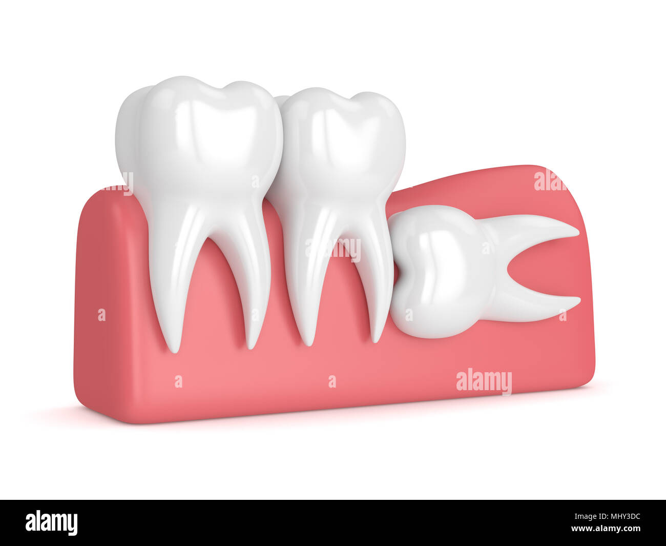 3d render of teeth with wisdom horizontal impaction over white ...