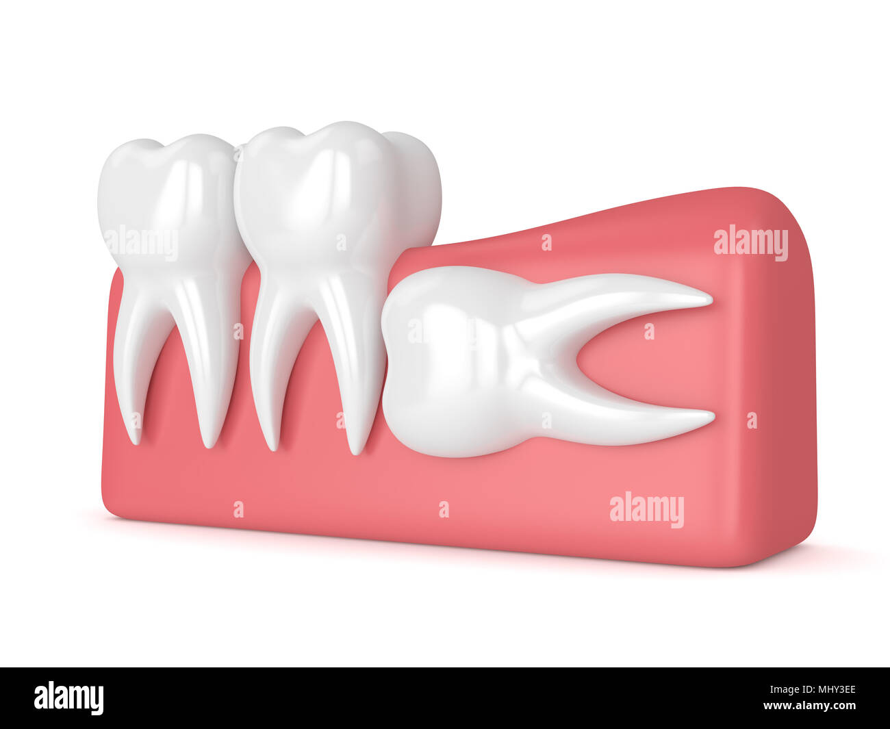 3d render of teeth with wisdom horizontal impaction over white ...