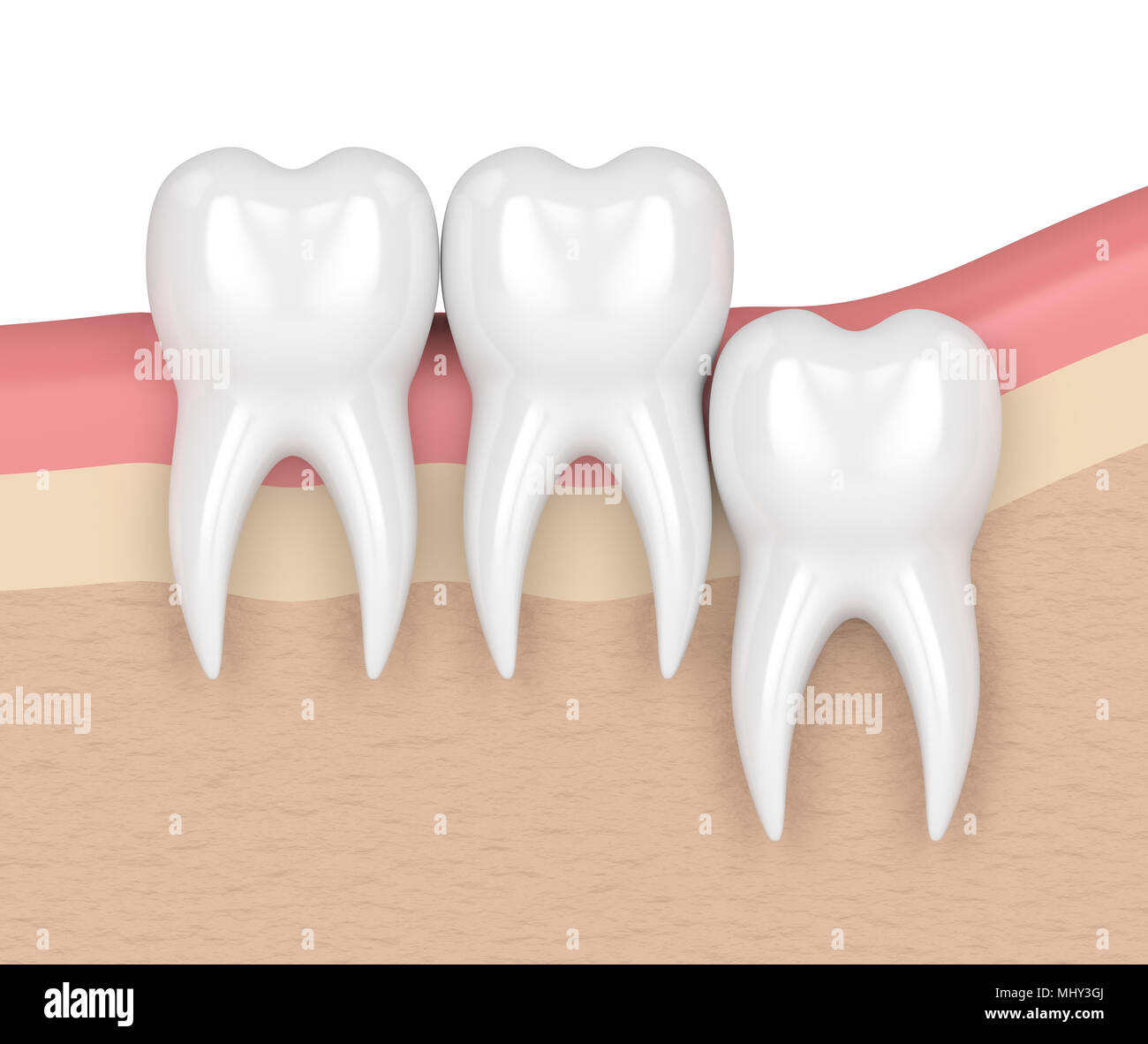3d render of teeth with wisdom vertical impaction. Concept of different ...