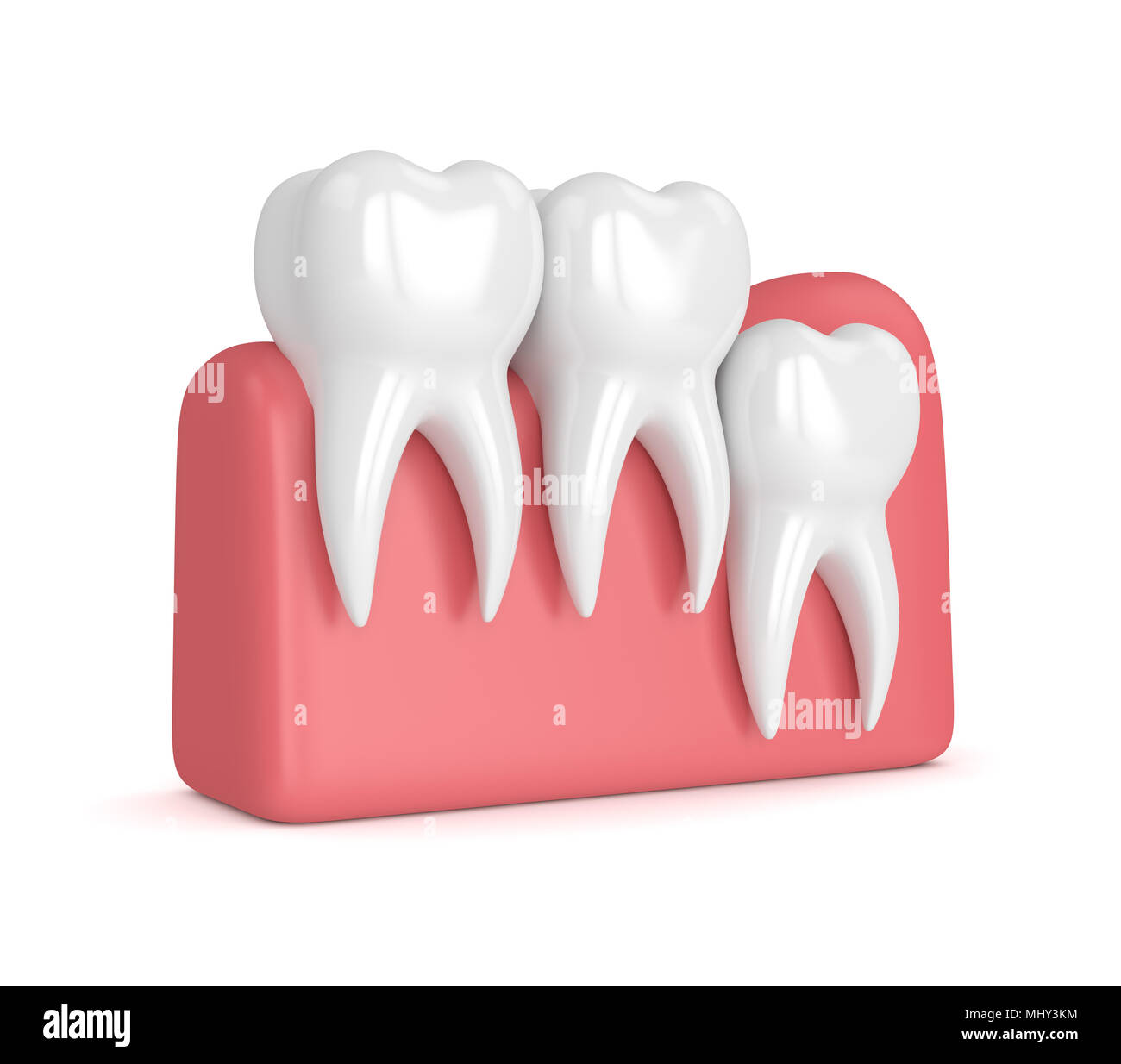 3d render of teeth with wisdom vertical impaction over white background ...