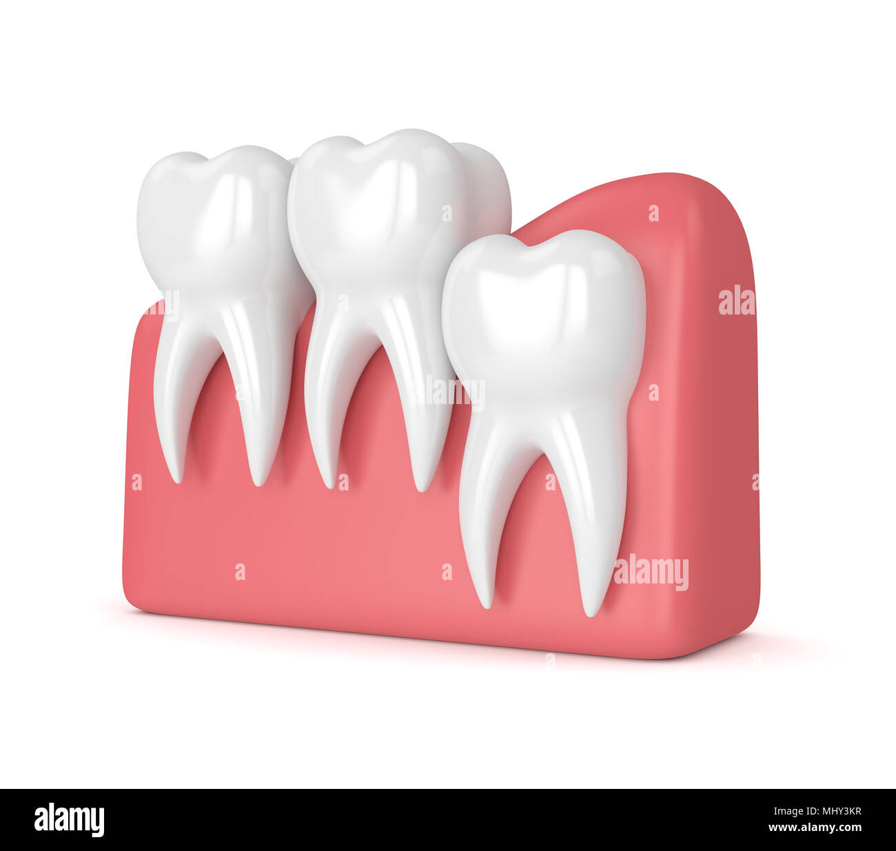 3d render of teeth with wisdom vertical impaction over white background ...