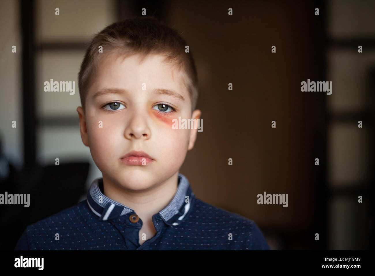 A boy with a black eye Stock Photo - Alamy