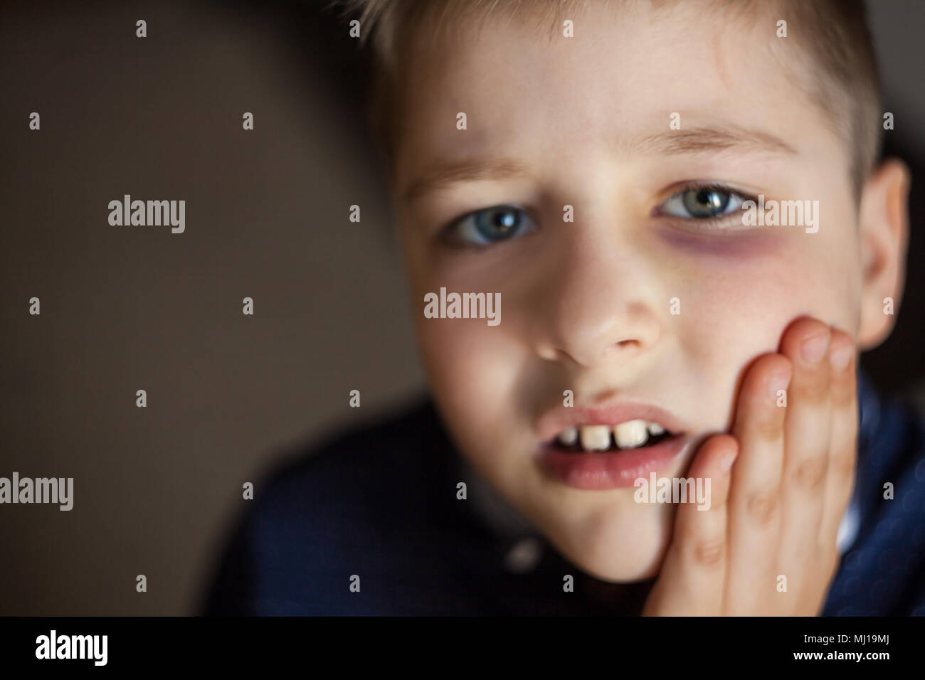 A boy with a black eye Stock Photo - Alamy
