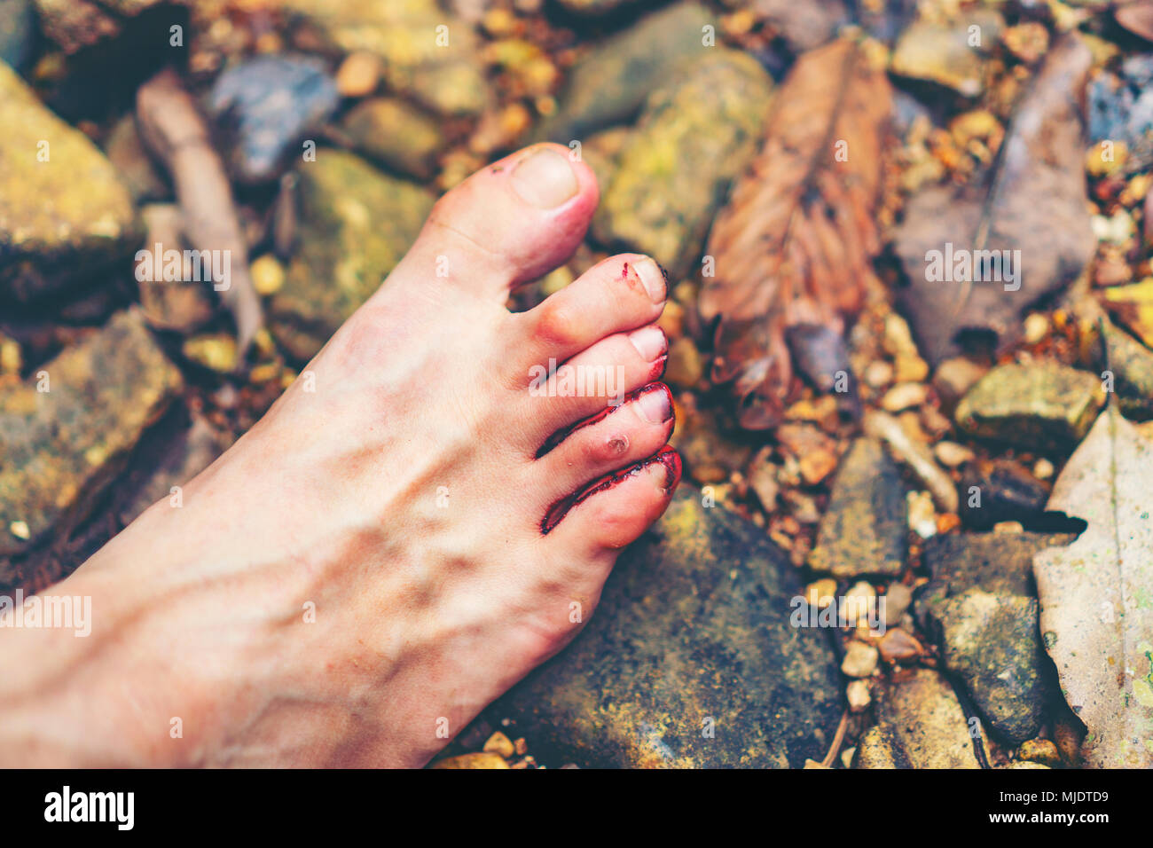 Leech Bite Stock Photos & Leech Bite Stock Images - Alamy