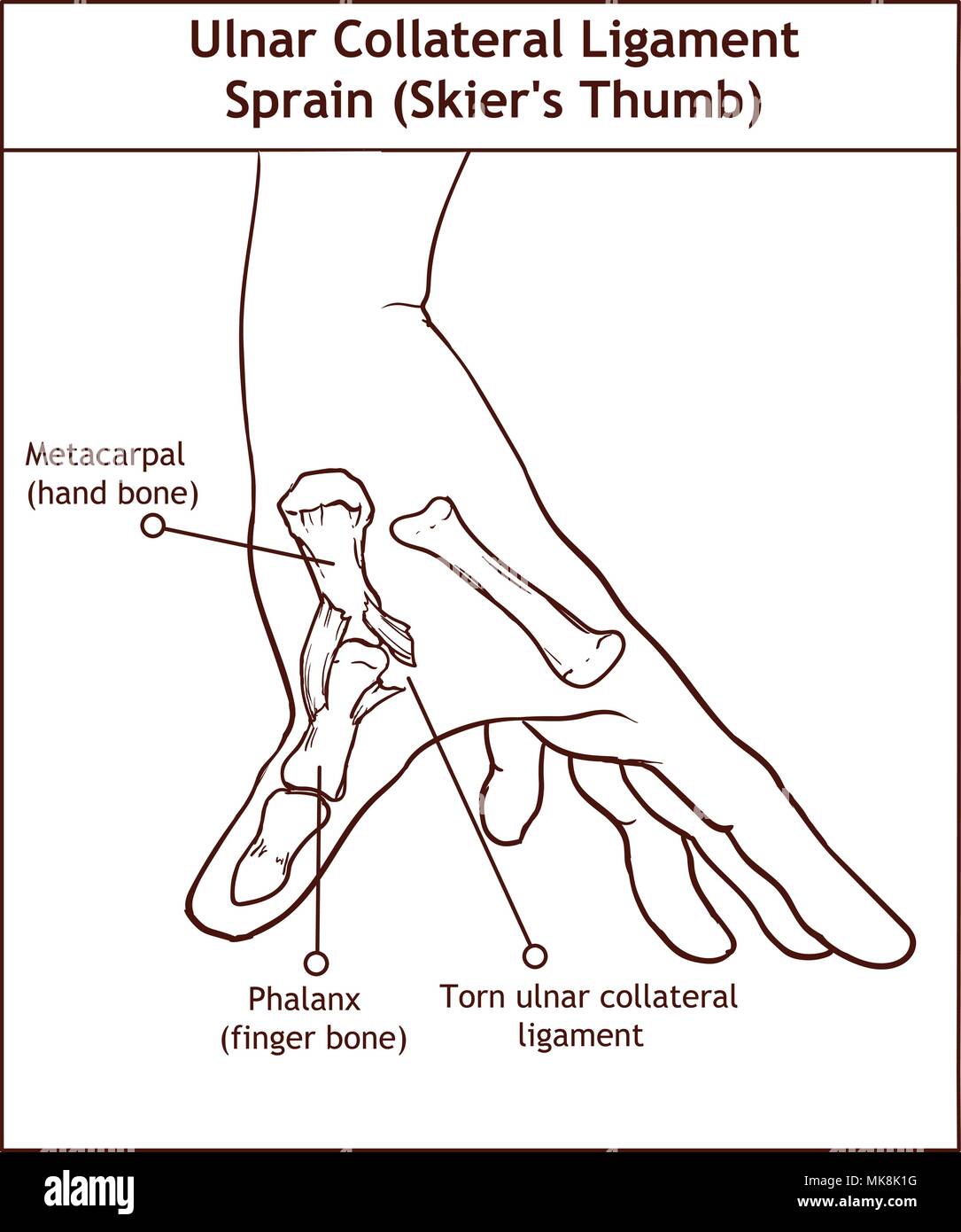 Ulnar Collateral Ligament Sprain (Skier's Thumb Stock Vector Image ...