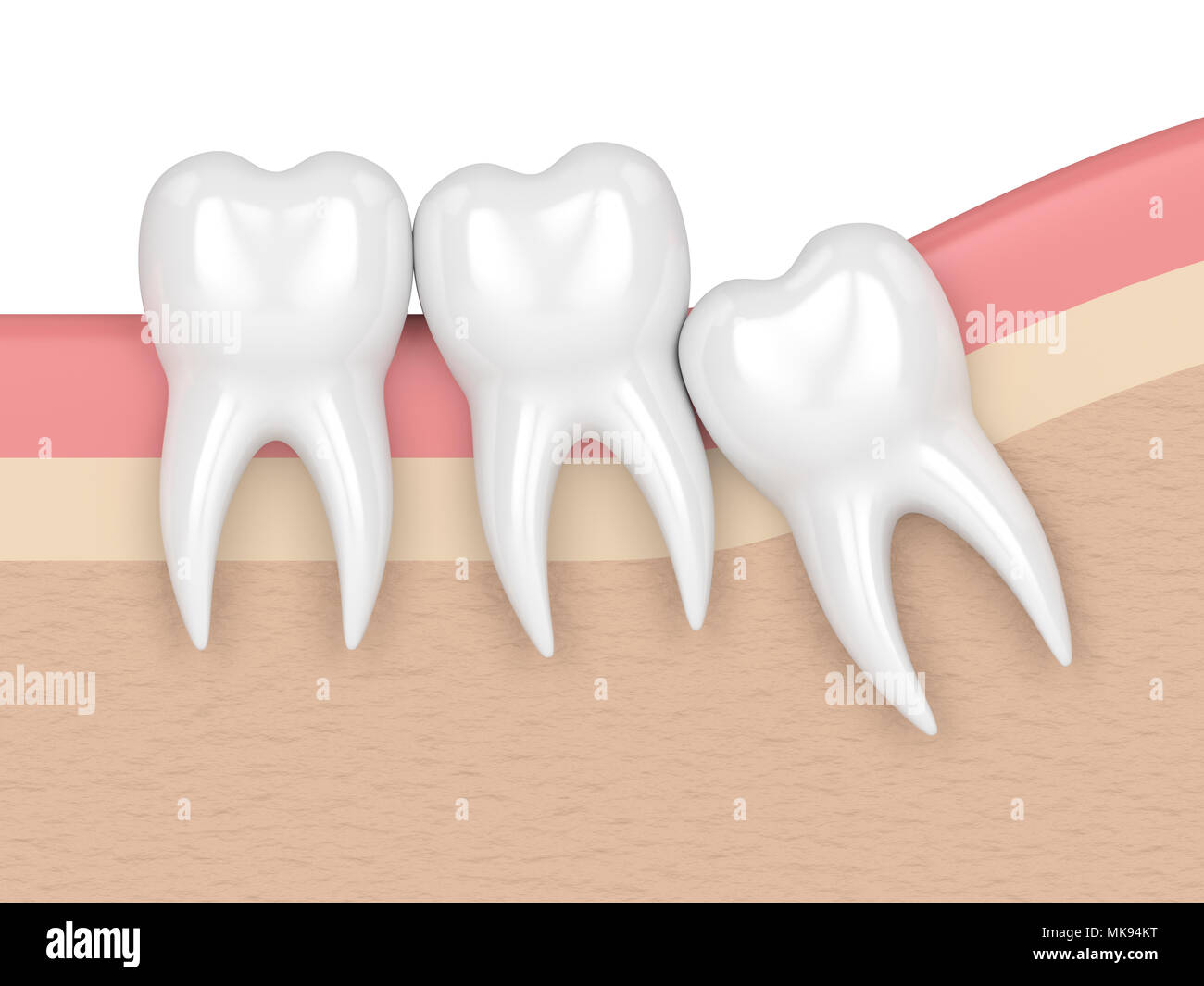 3d render of teeth with wisdom crowding. Concept of different types of ...