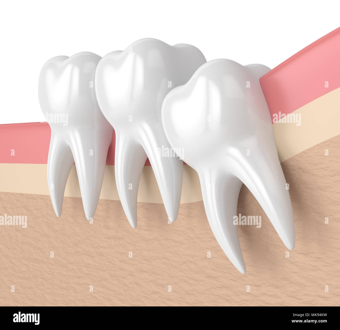 3d render of teeth with wisdom crowding. Concept of different types of ...