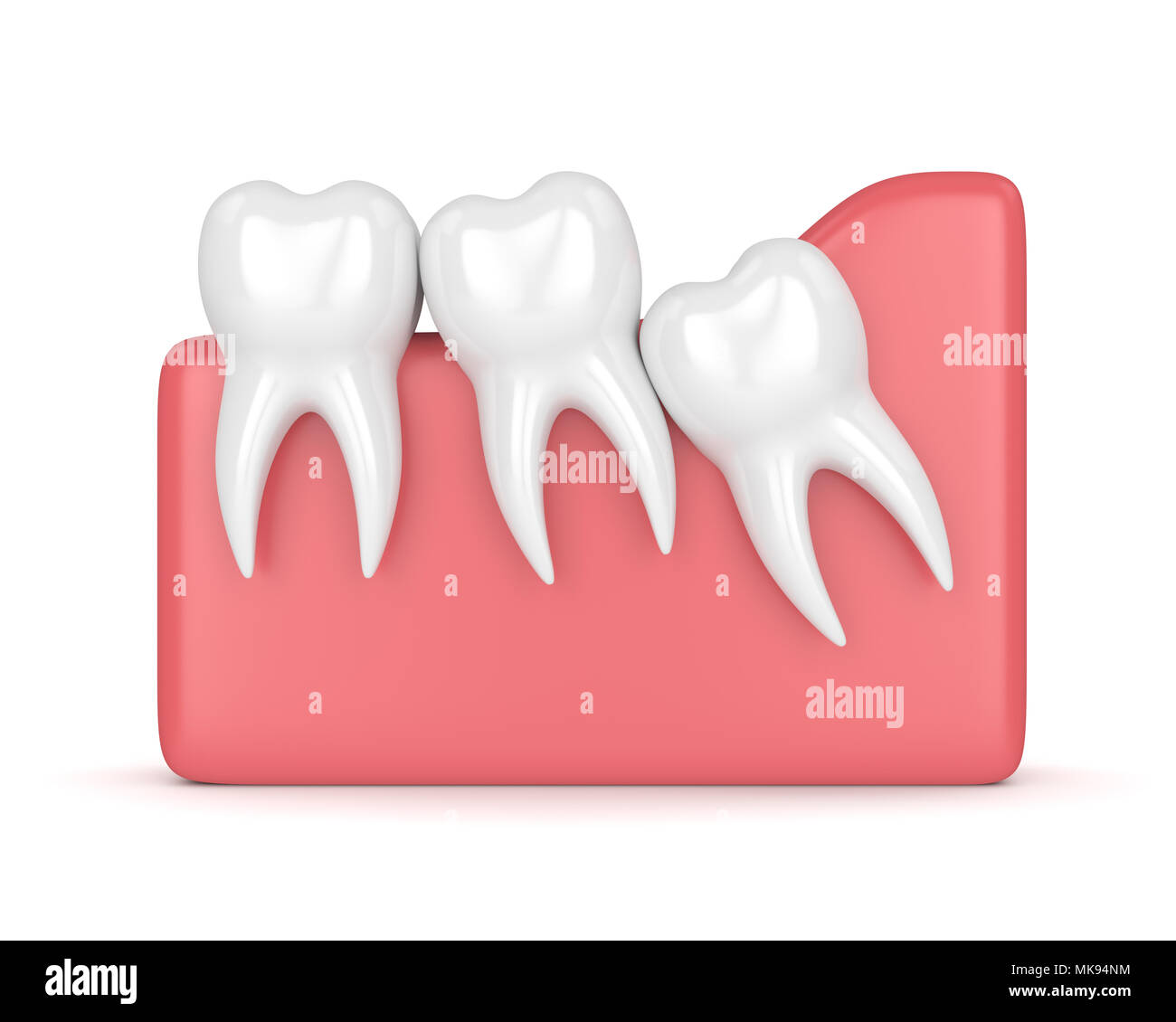 3d render of teeth with wisdom crowding over whie background. Concept ...