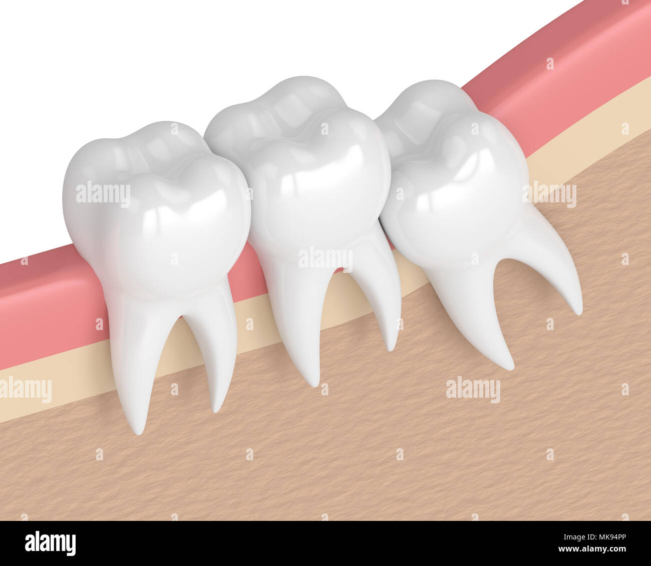 3d render of teeth with wisdom crowding. Concept of different types of ...
