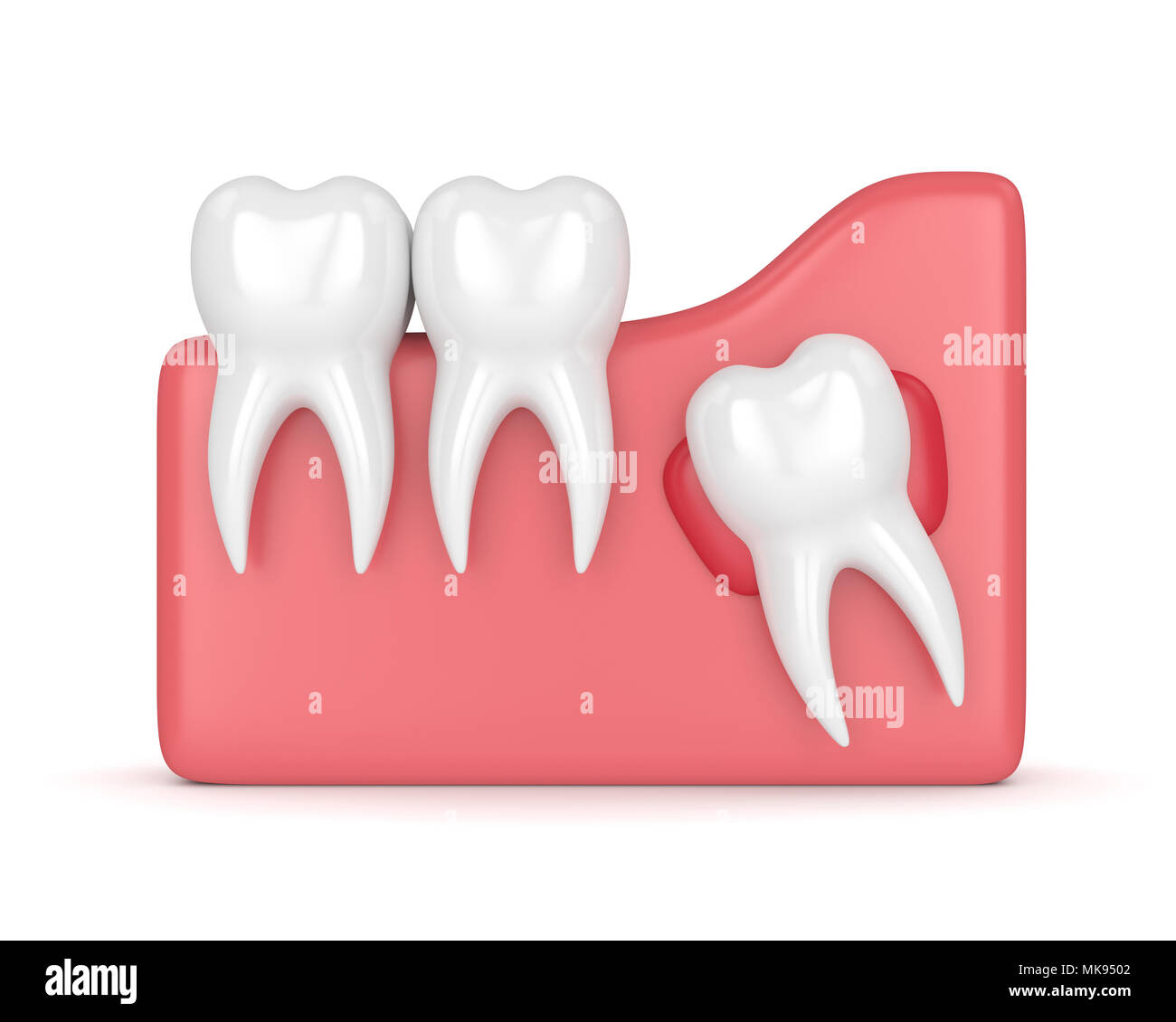 3d render of teeth with wisdom cyst over white background. Concept of ...