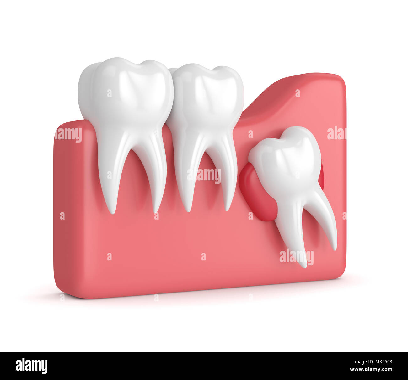 Impacted Wisdom Tooth Cyst