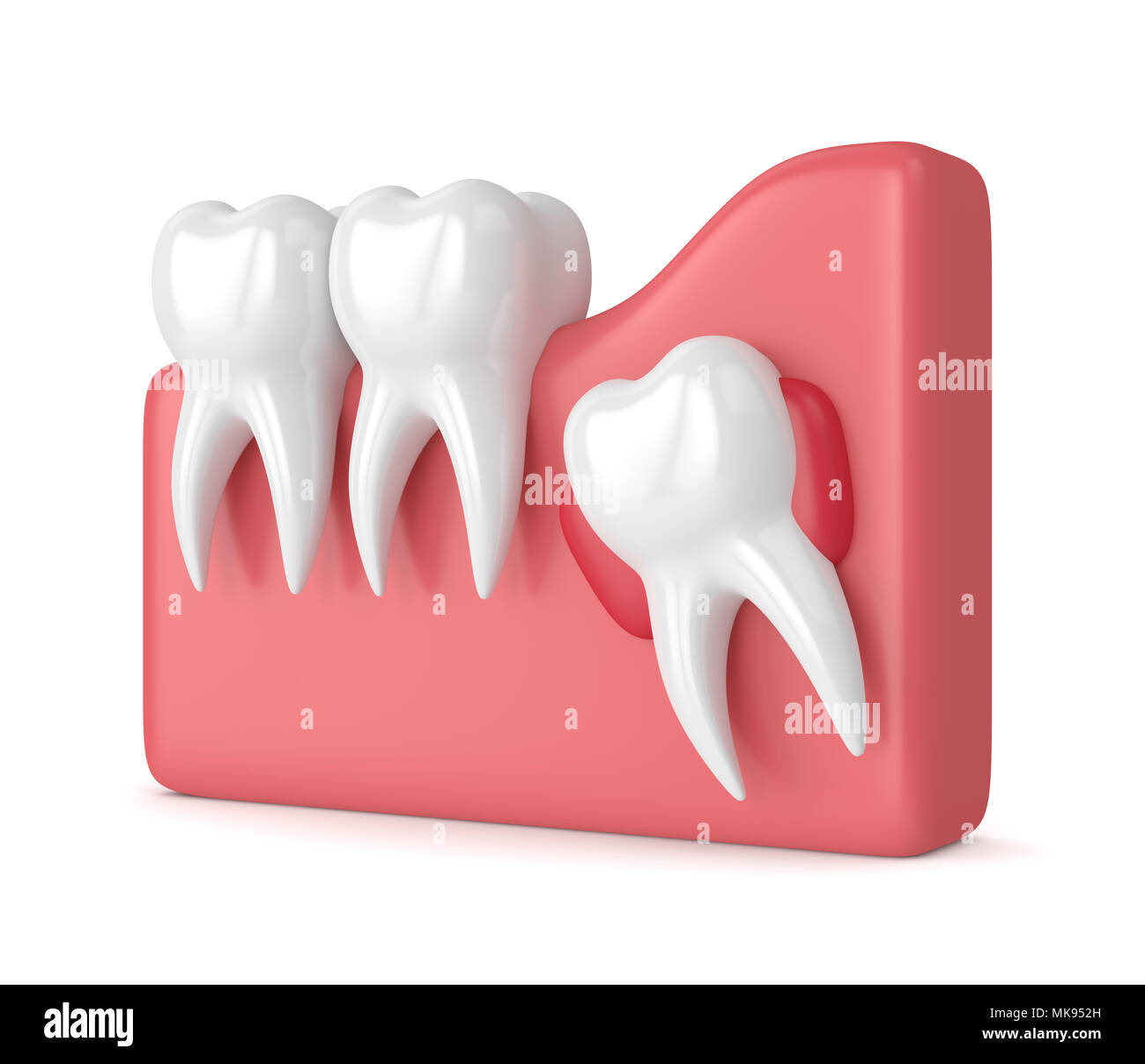 3d render of teeth with wisdom cyst over white background. Concept of ...