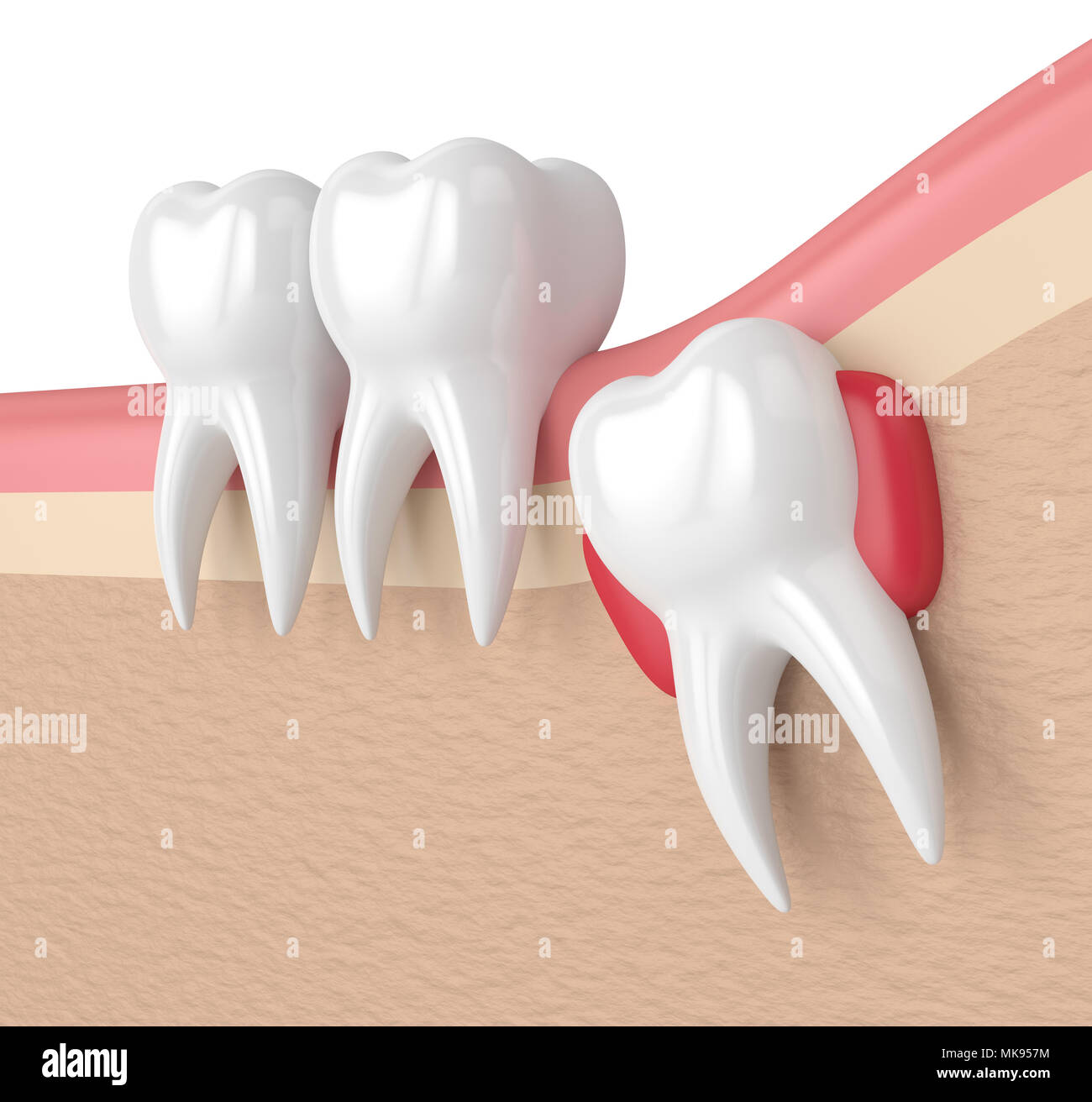 3d render of teeth with wisdom cyst. Concept of different types of ...