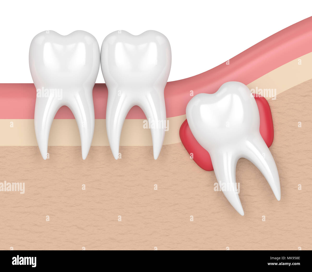 3d render of teeth with wisdom cyst. Concept of different types of ...