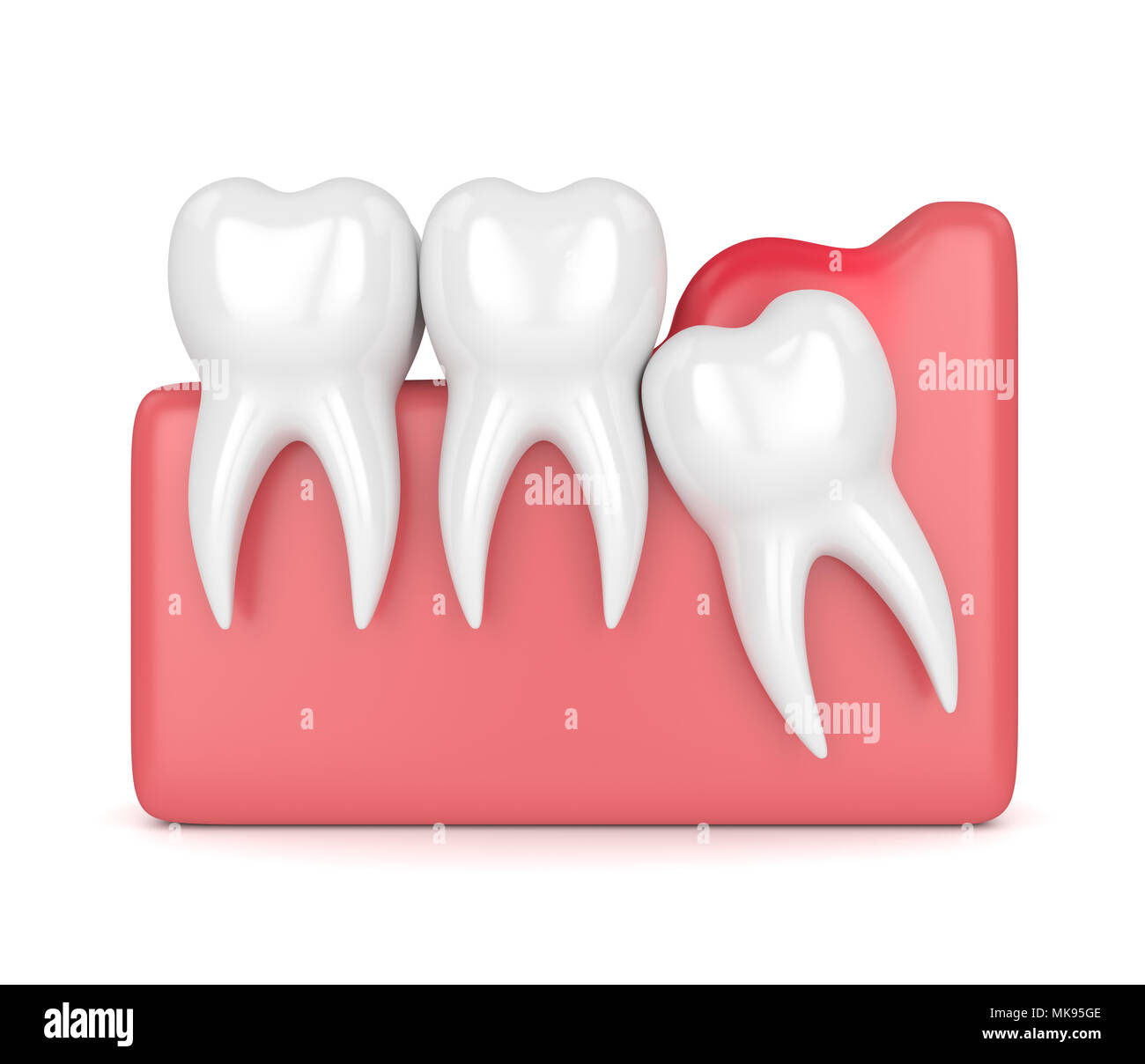 3d render of wisdom mesial impaction with pericoronitis over white ...