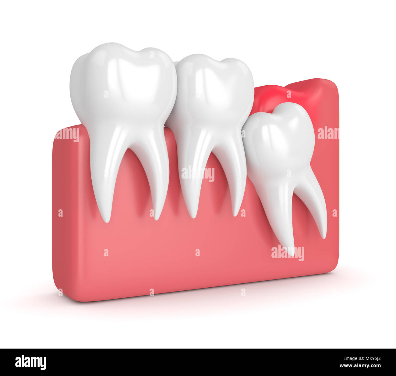 3d render of wisdom mesial impaction with pericoronitis over white ...