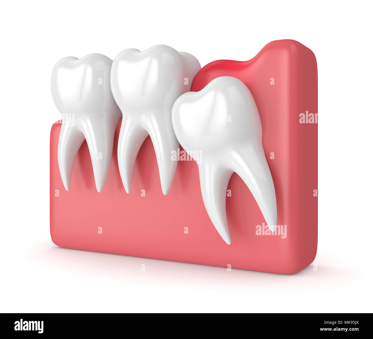 3d render of wisdom mesial impaction with pericoronitis over white ...