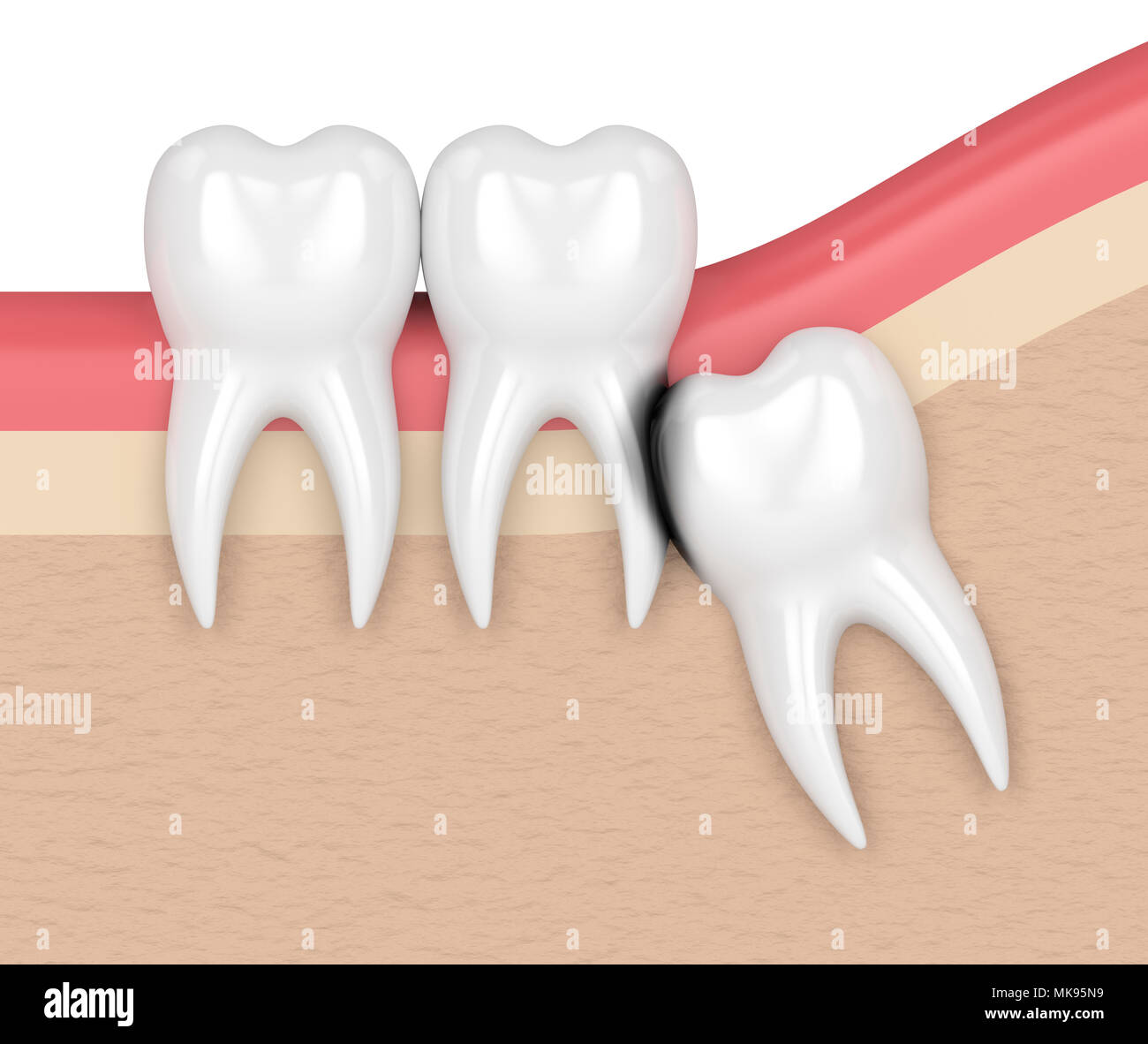 3d render of wisdom with erosion cavity. Concept of different types of ...